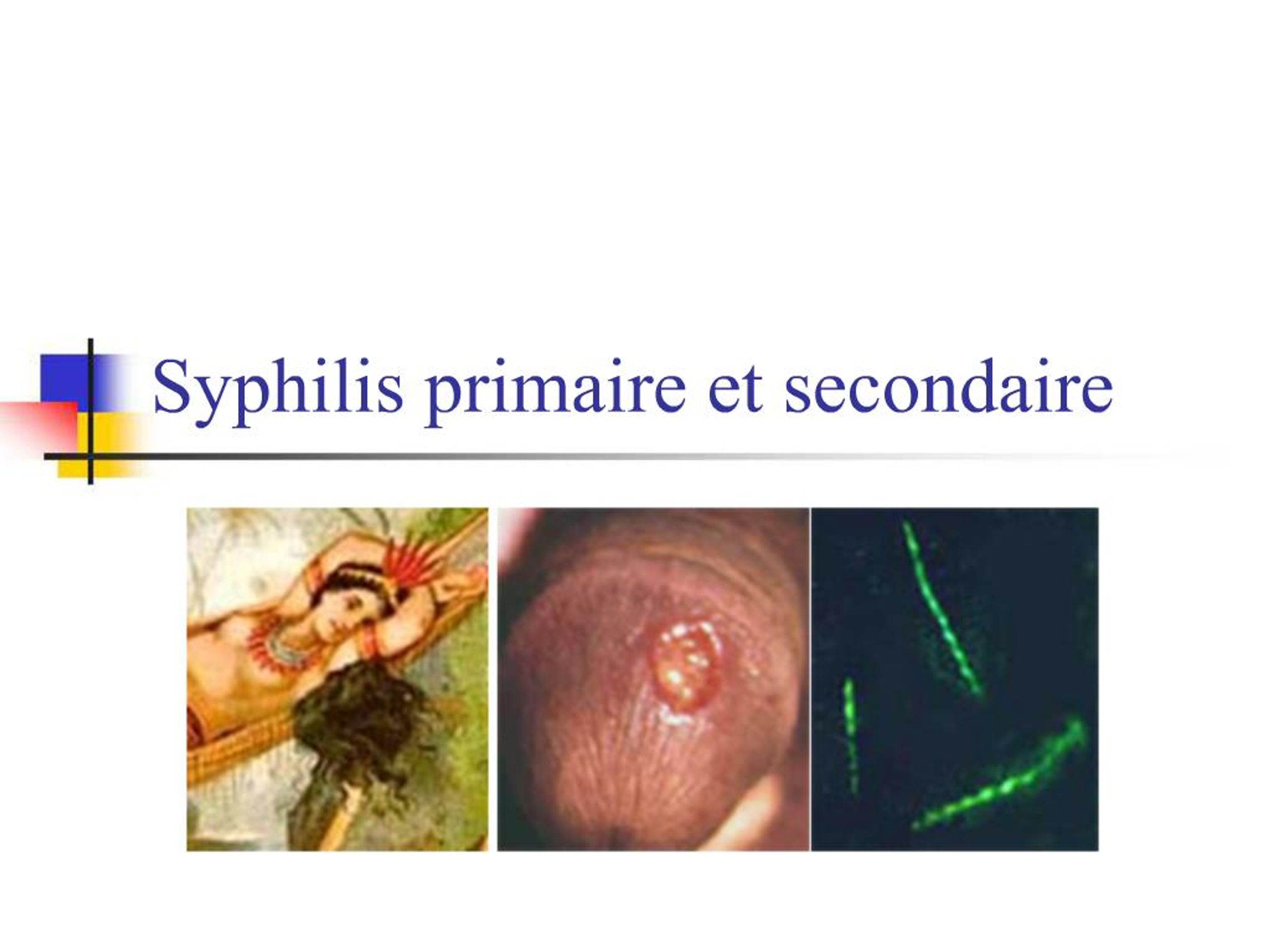 PPT - Syphilis primaire et secondaire PowerPoint Presentation, free ...