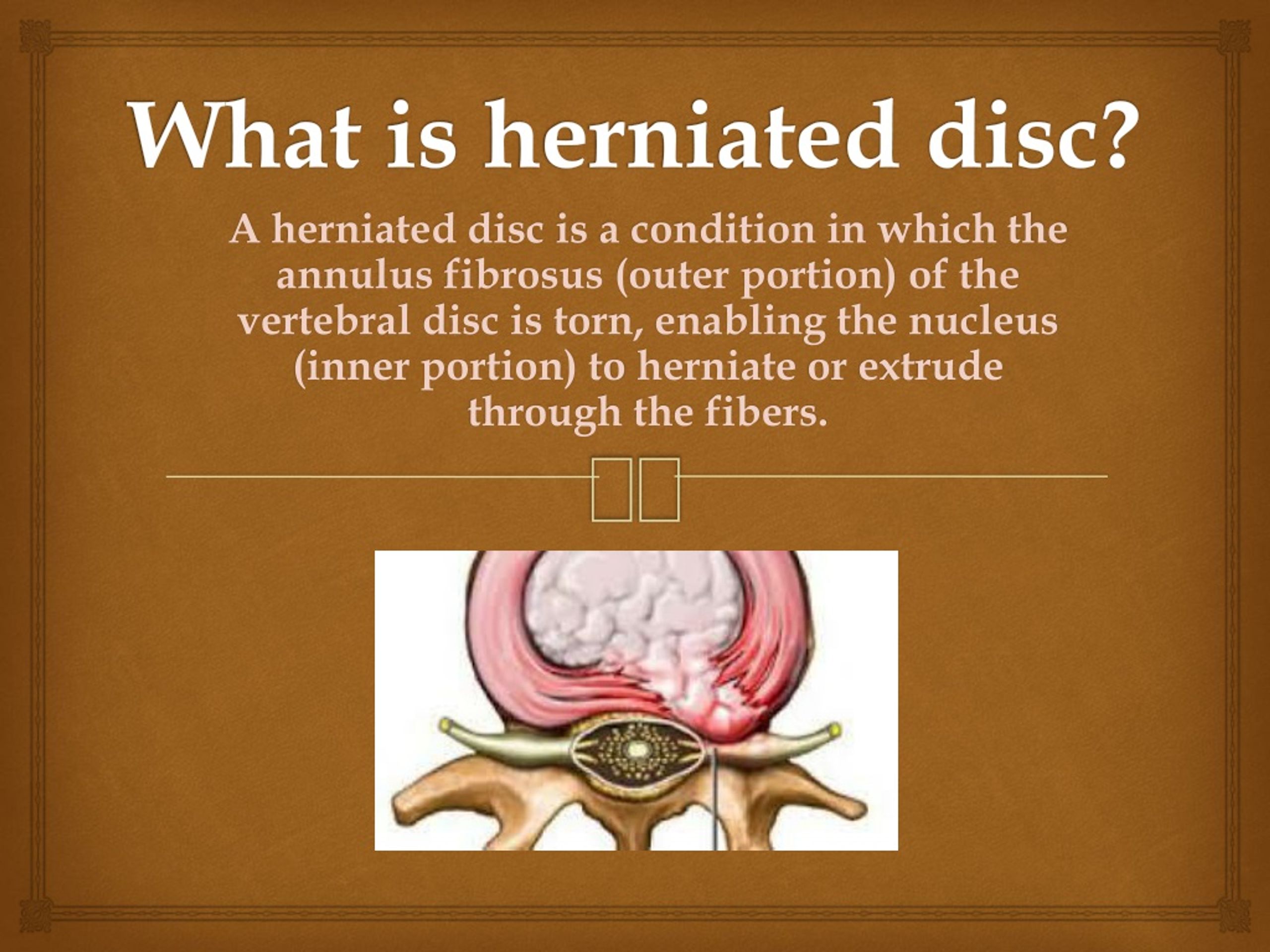 PPT - What is herniated disc? PowerPoint Presentation, free download ...