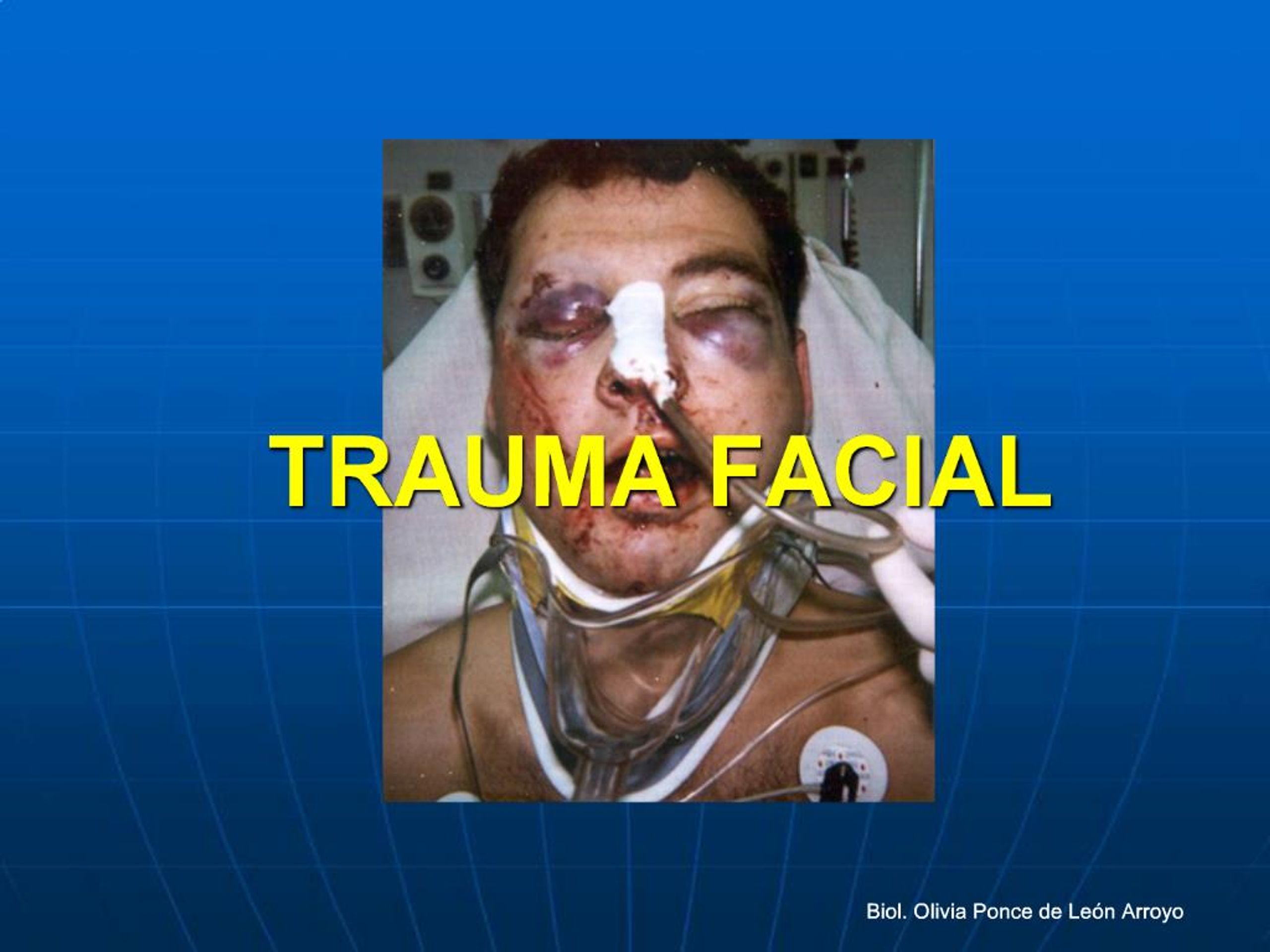 PPT - TRAUMA FACIAL PowerPoint Presentation, free download - ID:1244294