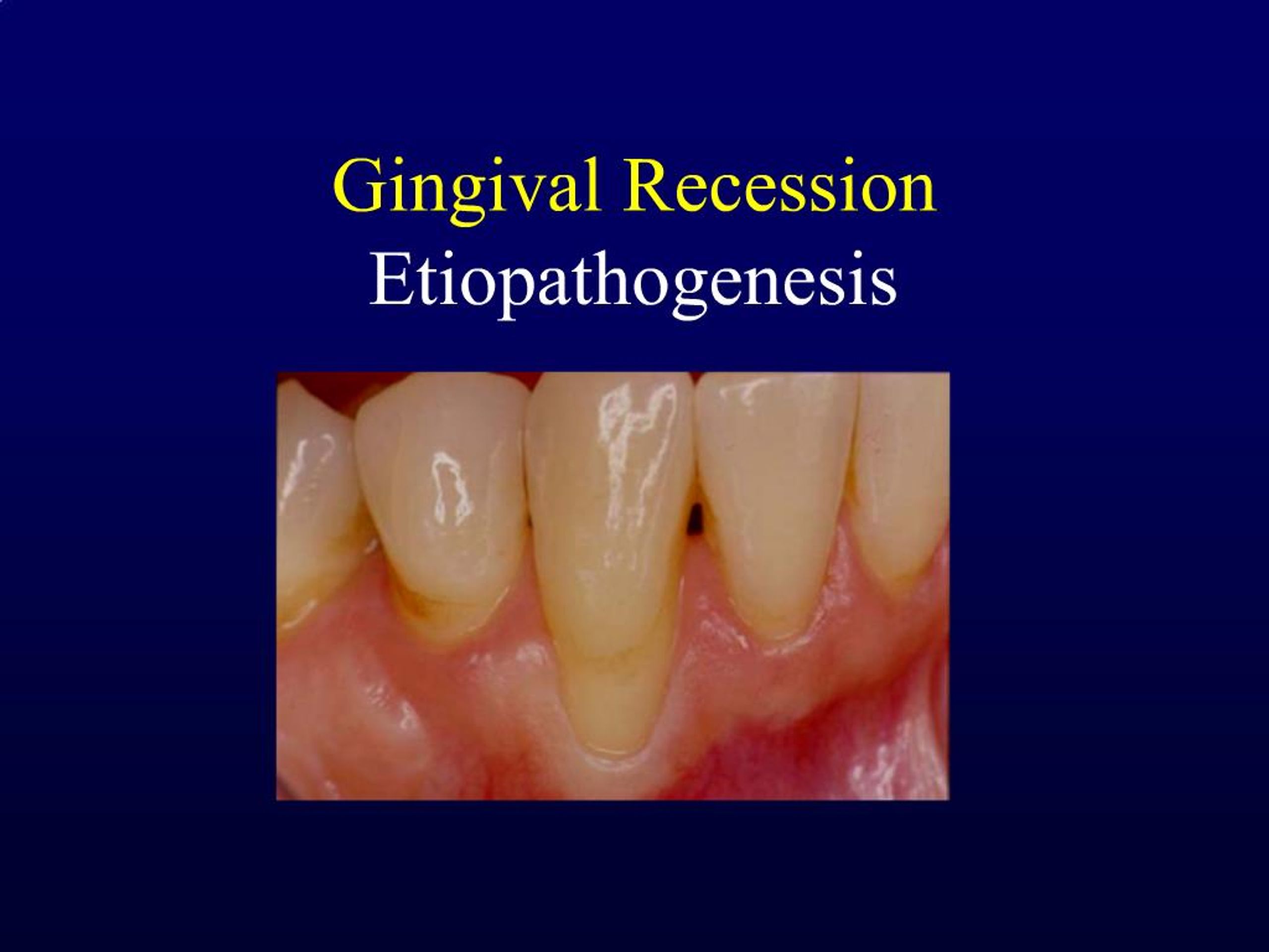 PPT - Gingival Recession Etiopathogenesis PowerPoint Presentation, free ...