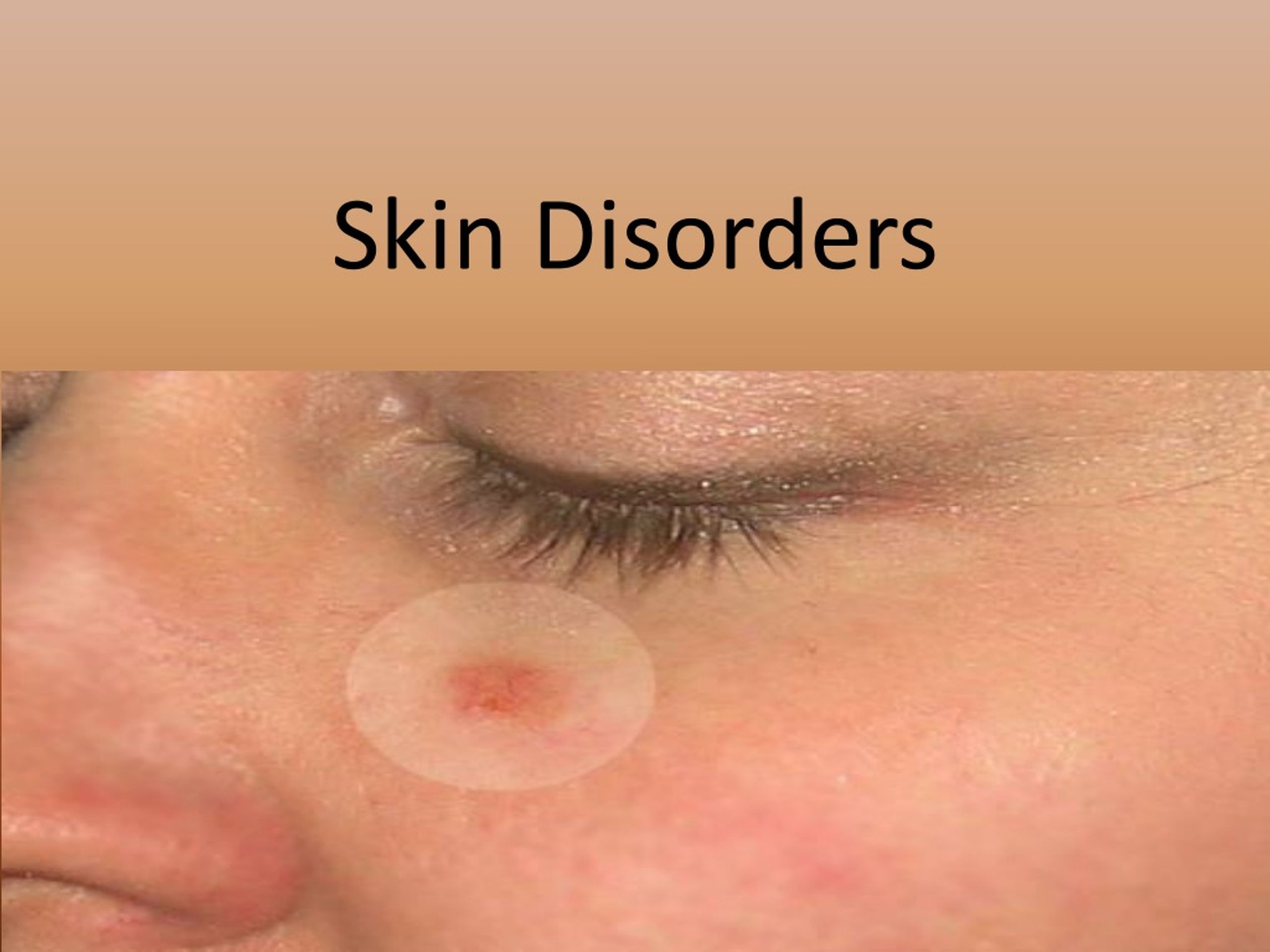 PPT - Skin disorders PowerPoint Presentation, free download - ID:1299238