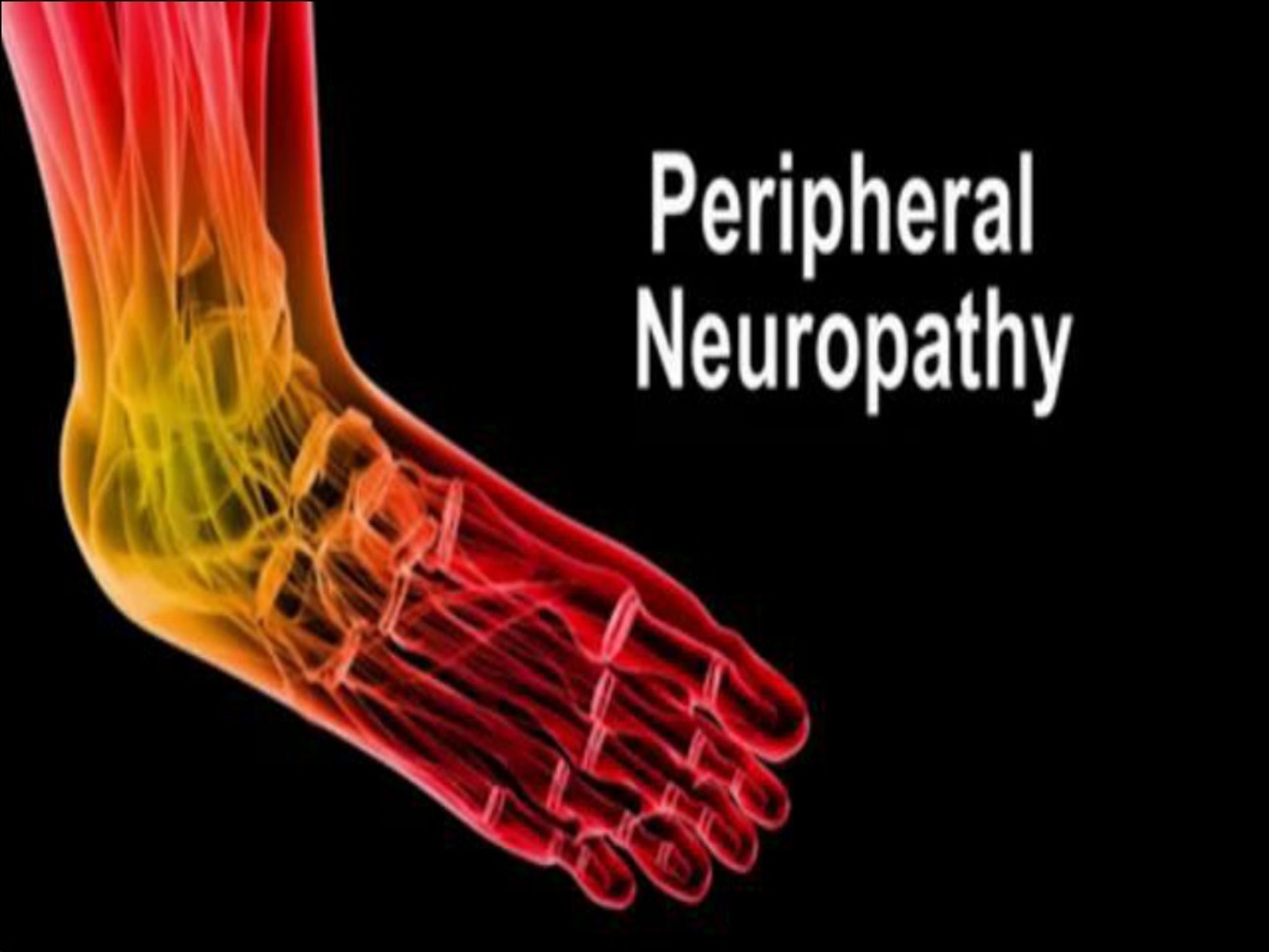 PPT - Peripheral Neuropathy PowerPoint Presentation, free download - ID ...