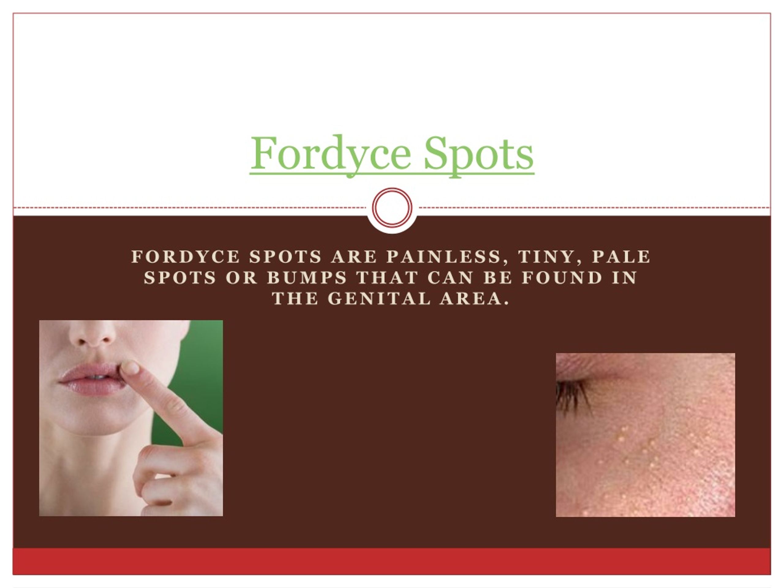 PPT - Fordyce Spots Treatment PowerPoint Presentation, free download ...