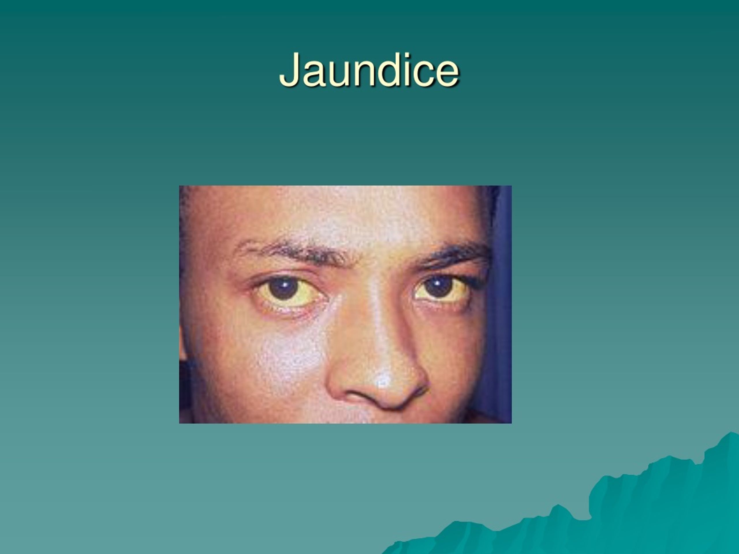 PPT - Jaundice PowerPoint Presentation, free download - ID:350756