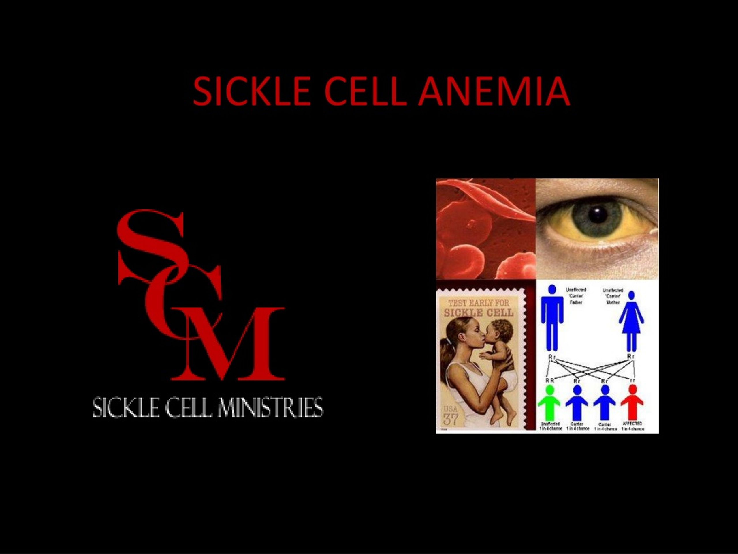 PPT - SICKLE CELL ANEMIA PowerPoint Presentation, free download - ID:393020