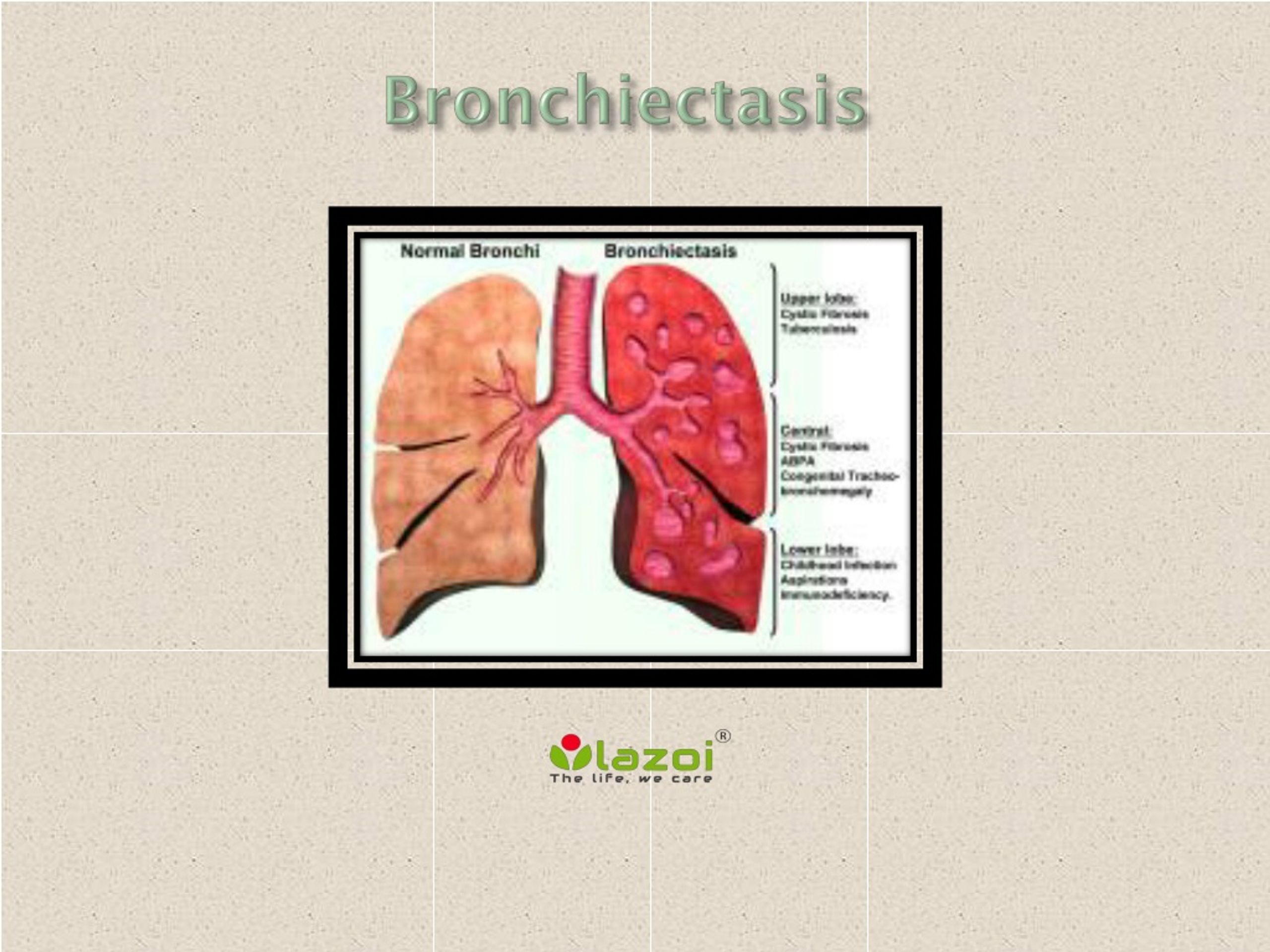PPT - Bronchiectasis PowerPoint Presentation, free download - ID:424755