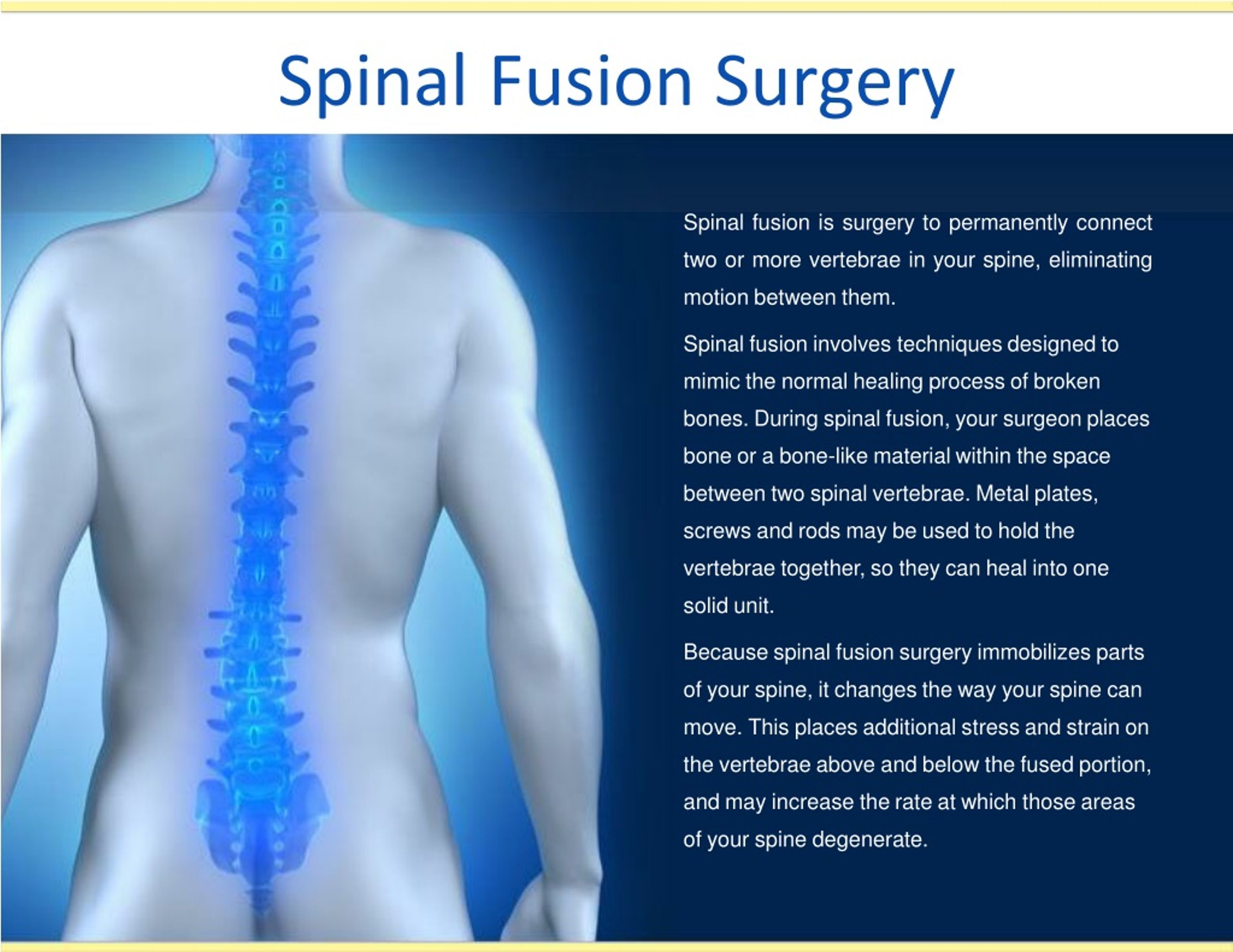 PPT - Spinal Fusion Surgery PowerPoint Presentation, free download - ID ...