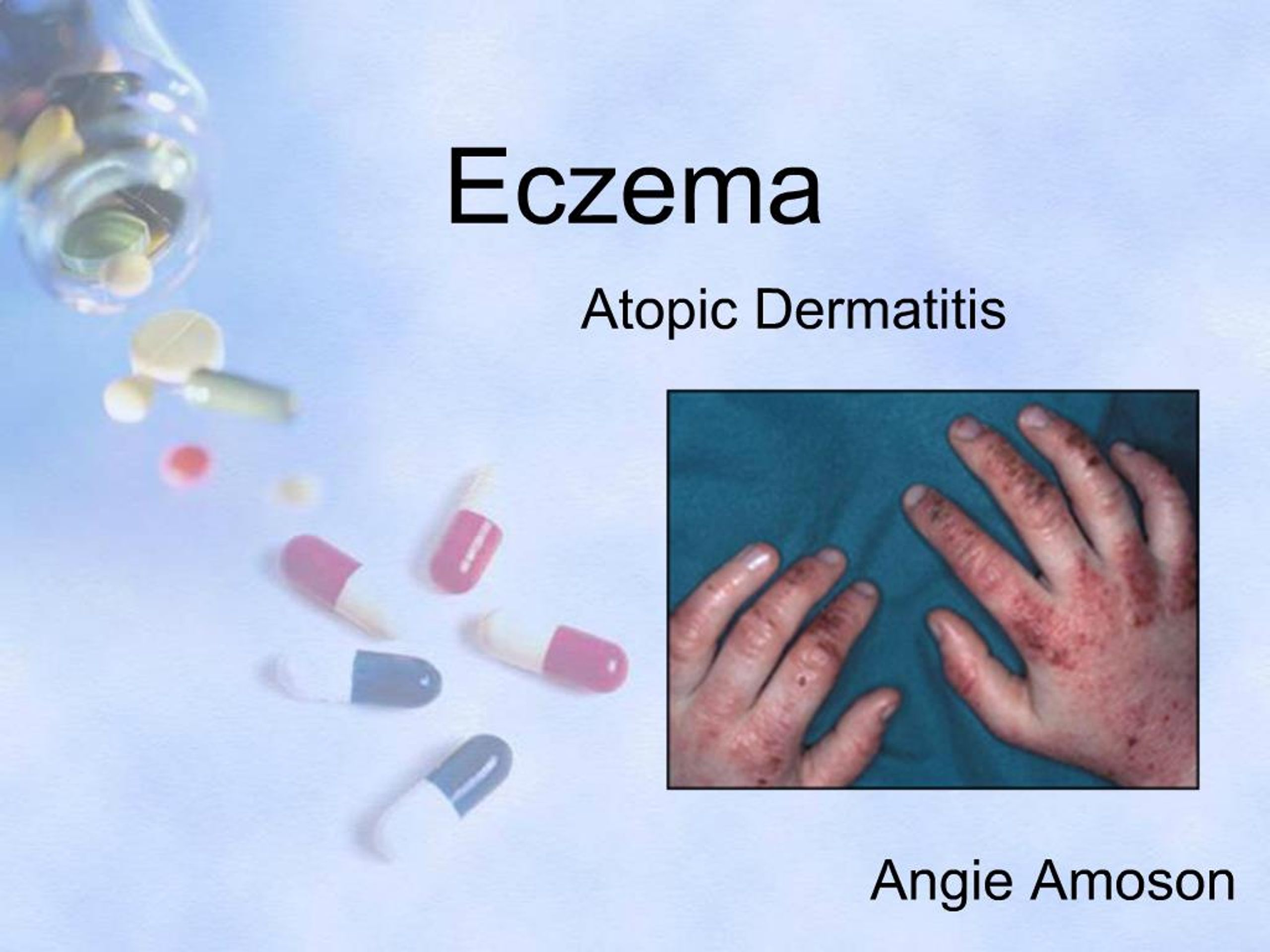 PPT - Eczema PowerPoint Presentation, free download - ID:617846