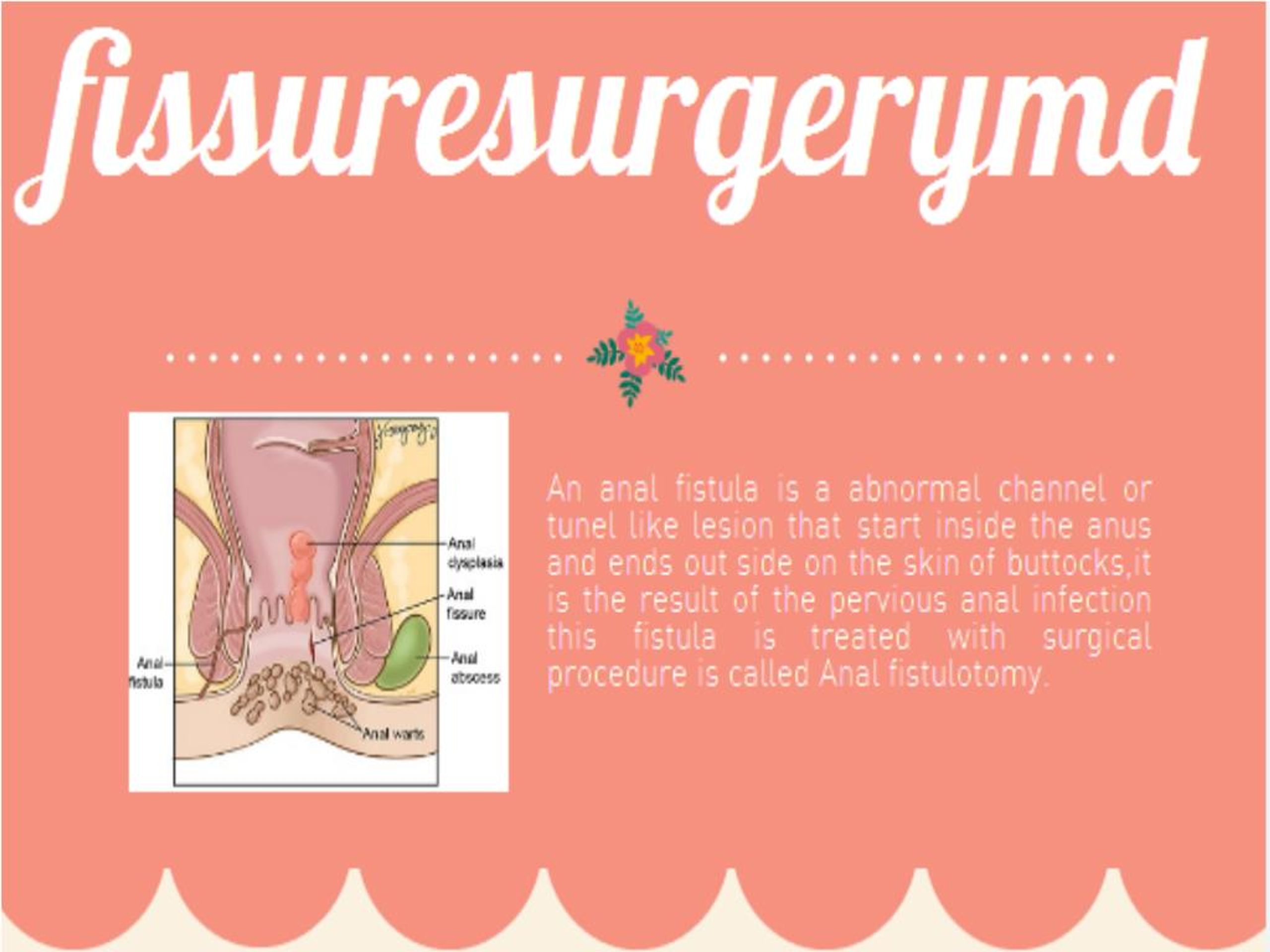 PPT - Fistulectomy Surgery PowerPoint Presentation, free download - ID ...