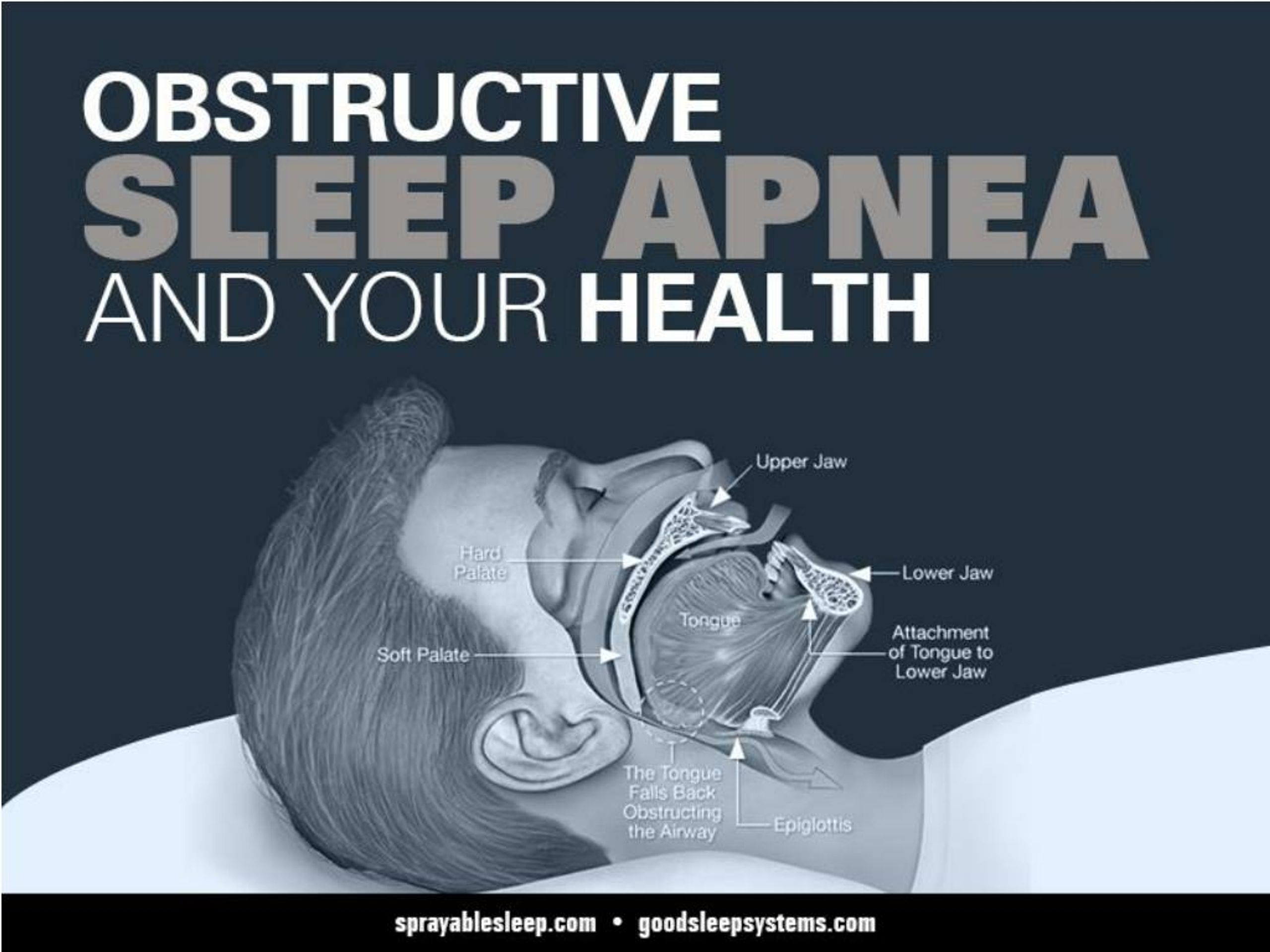 PPT - Obstructive Sleep Apnea and your Health PowerPoint Presentation ...