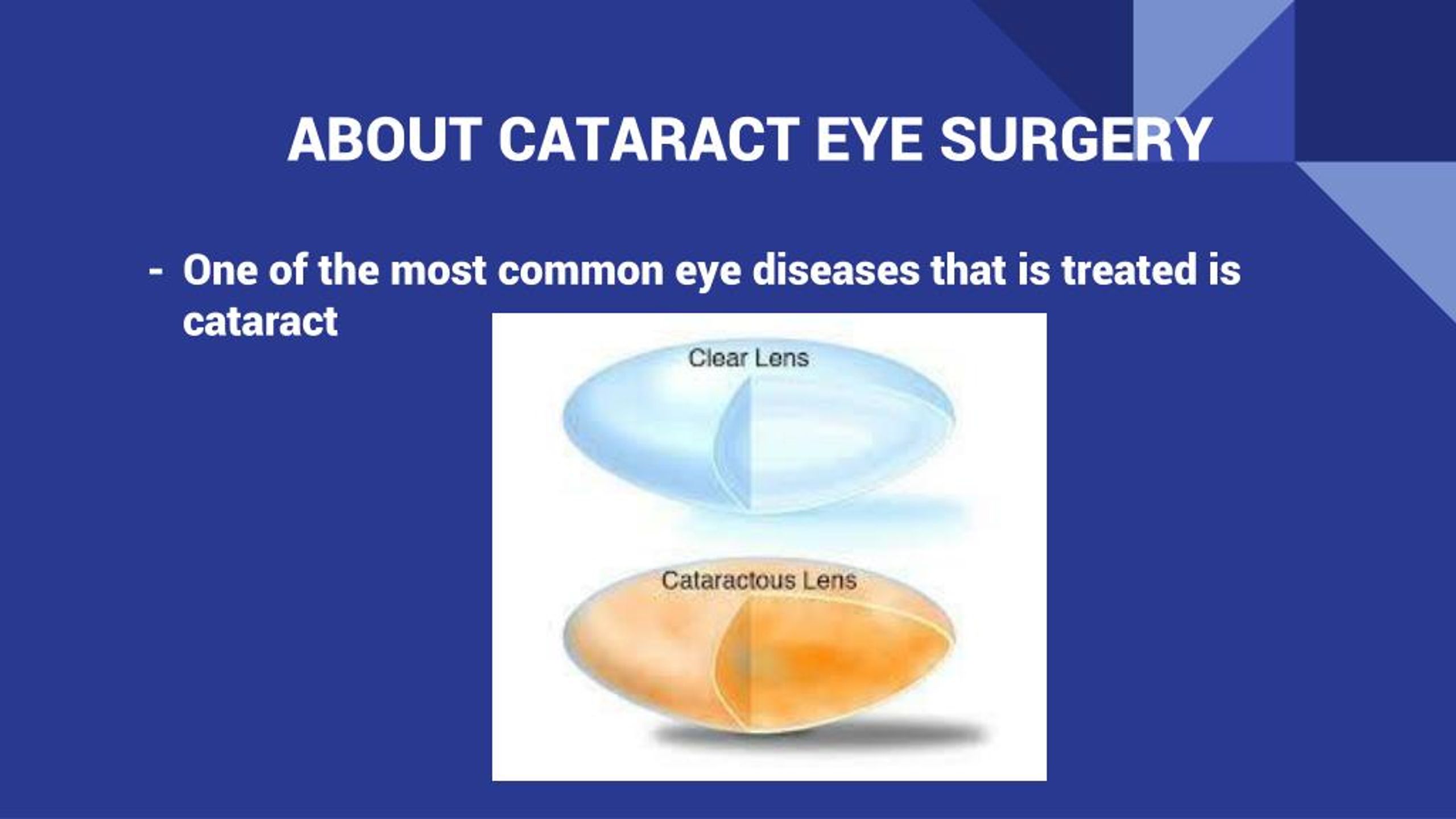 PPT - ABOUT CATARACT EYE SURGERY PowerPoint Presentation, free download ...