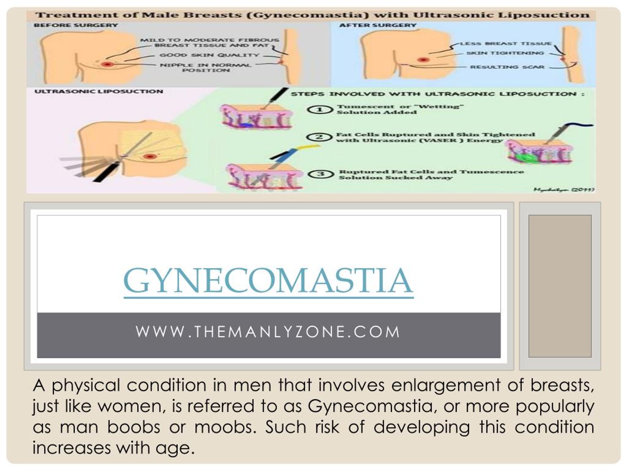 PPT - Gynecomastia PowerPoint Presentation, free download - ID:7314473