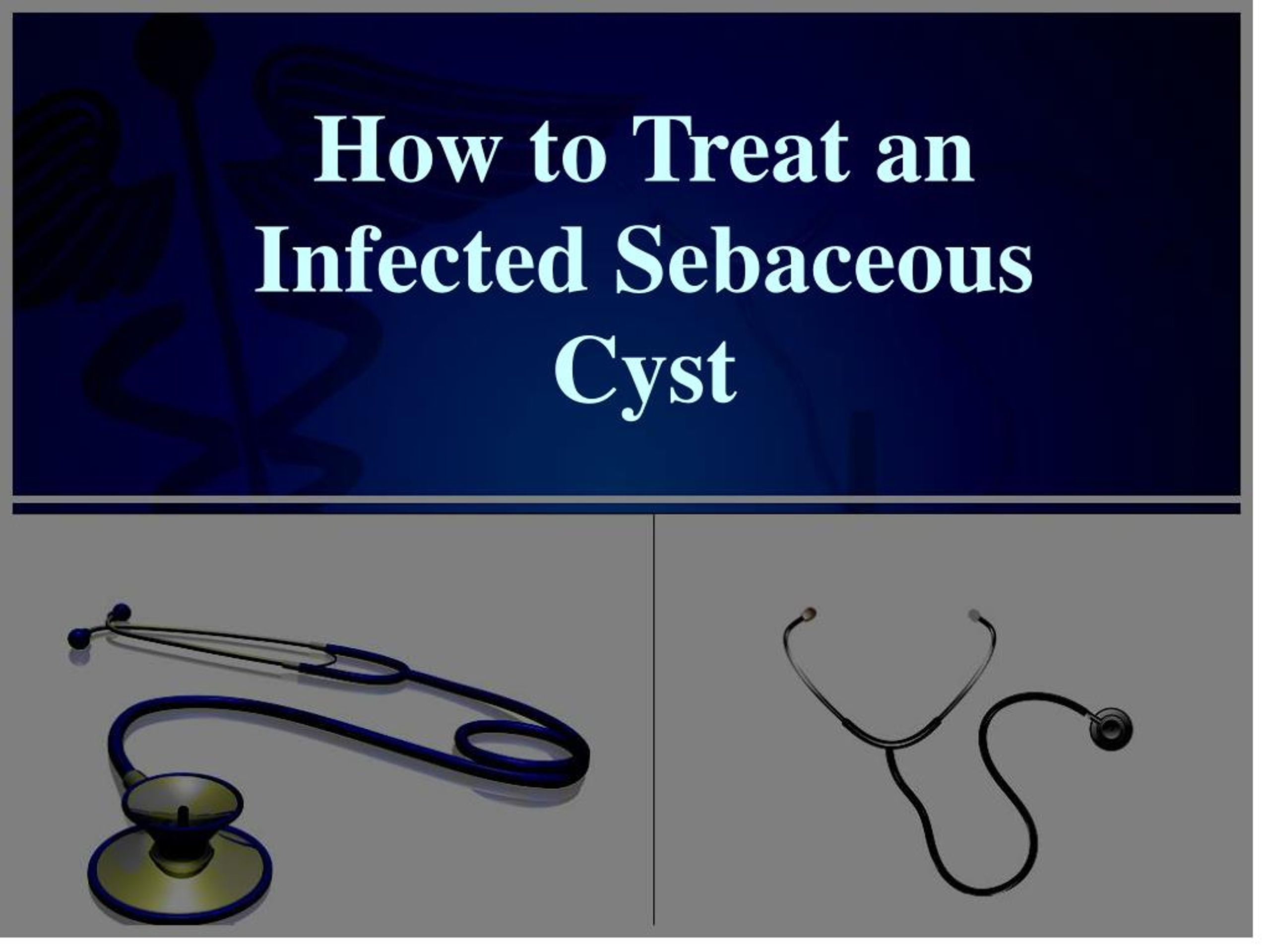 PPT - How to Treat an Infected Sebaceous Cyst PowerPoint Presentation ...
