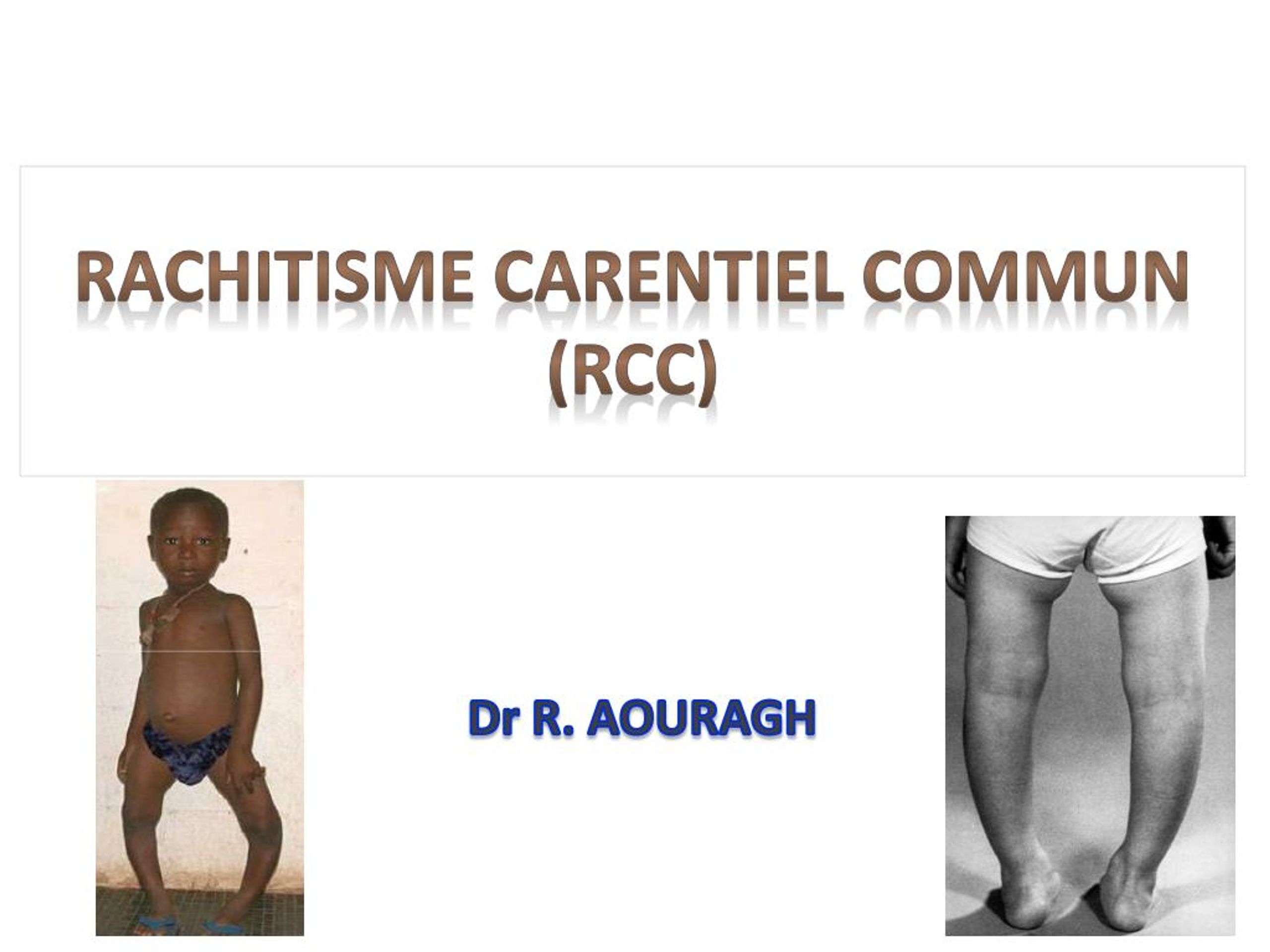 PPT - Rachitisme carentiel commun PowerPoint Presentation, free ...