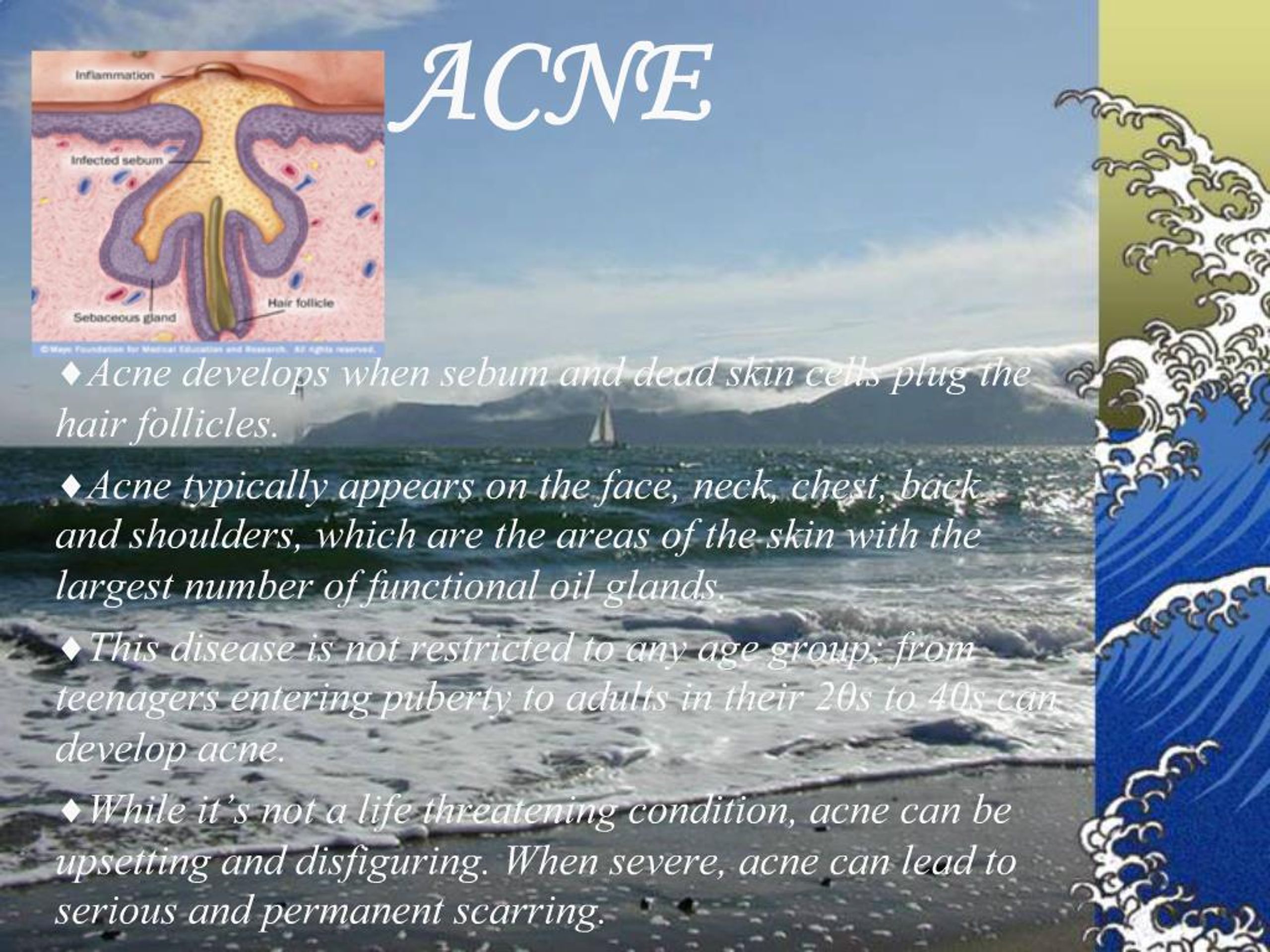 PPT - ACNE PowerPoint Presentation, free download - ID:736965