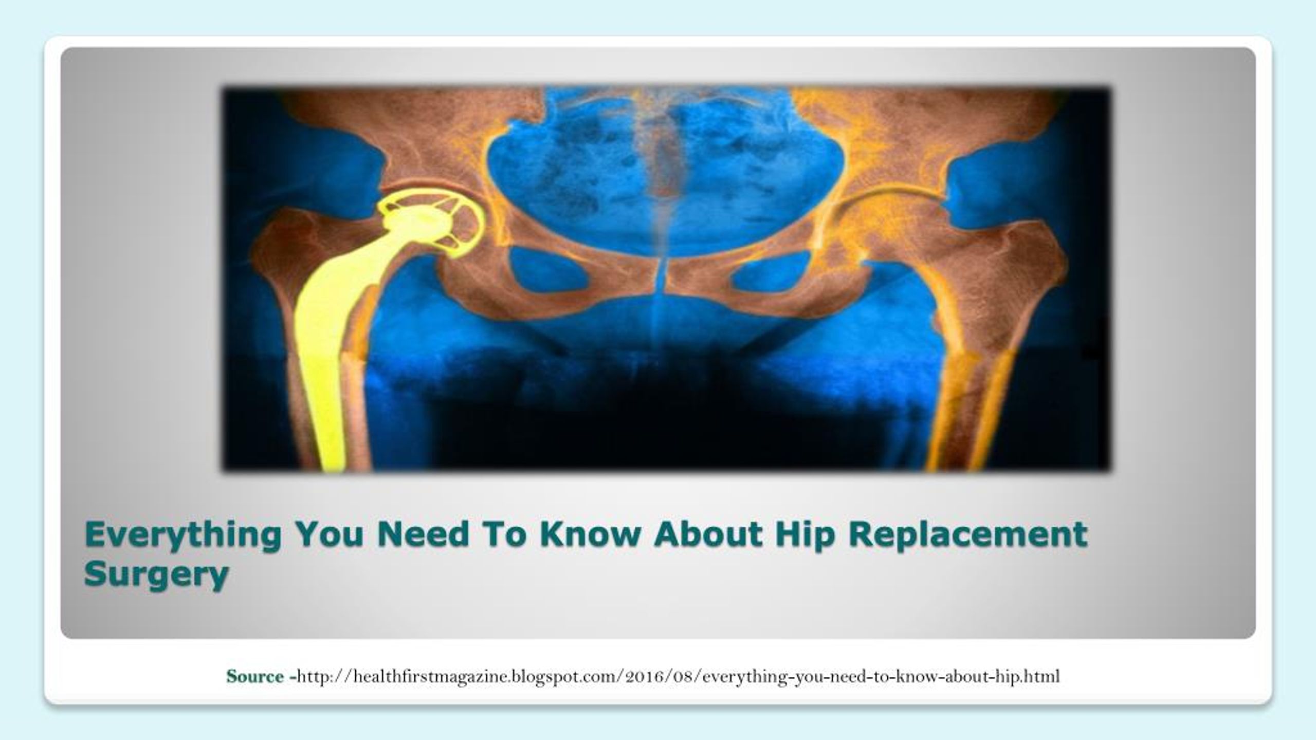 PPT - Everything You Need To Know About Hip Replacement Surgery ...