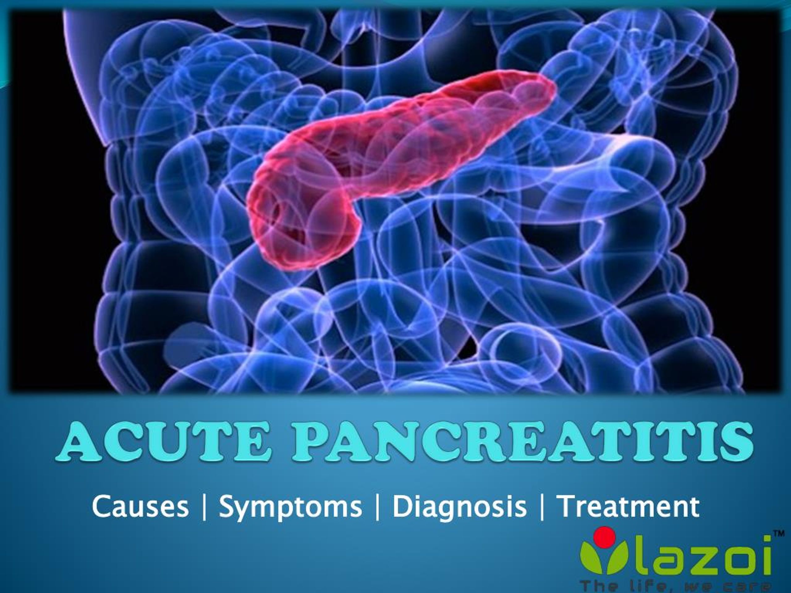 PPT - Acute pancreatitis causes symptoms and treatments PowerPoint ...