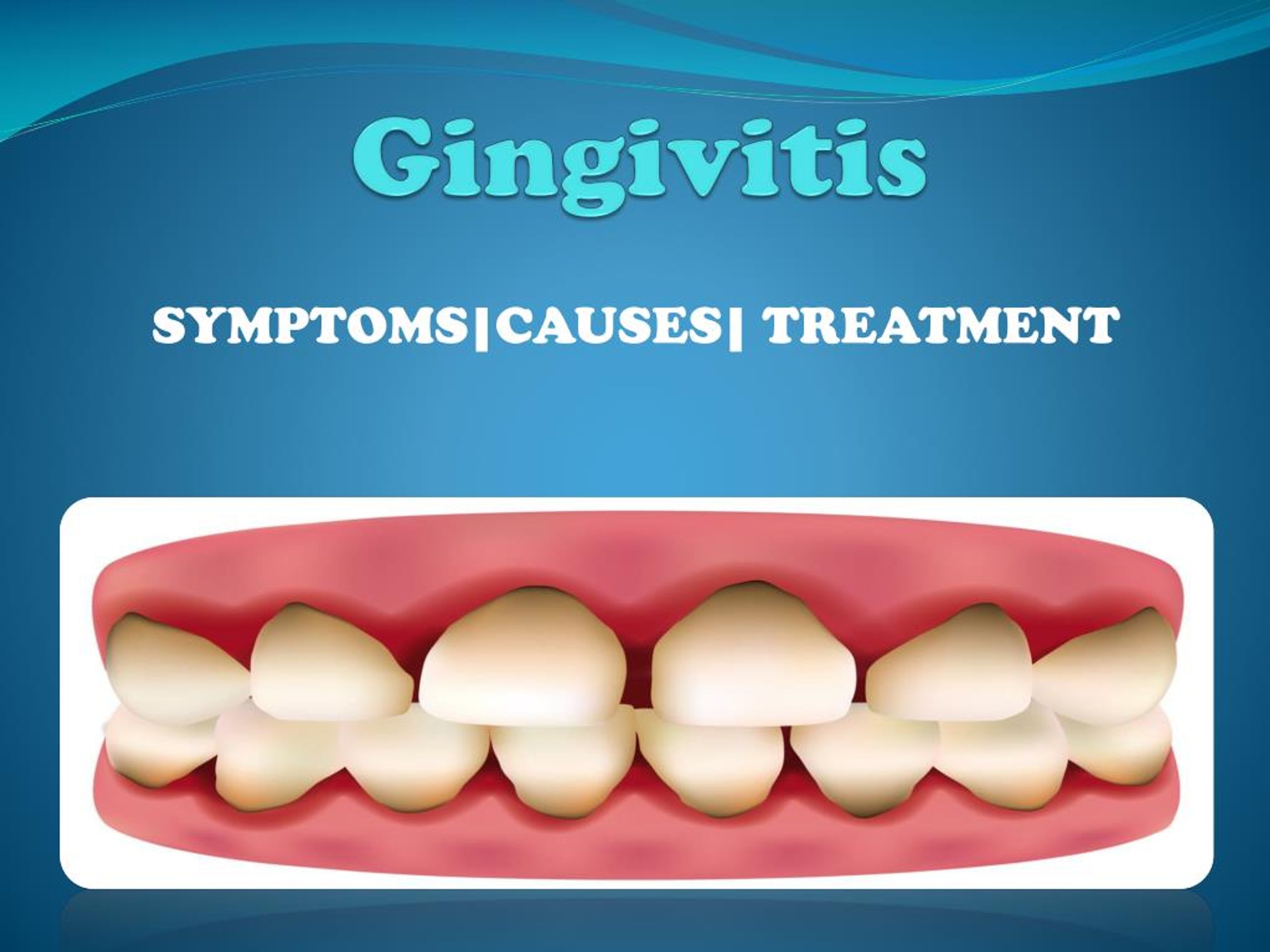 PPT - Gingivitis (Mild Gum Disease) PowerPoint Presentation, free ...