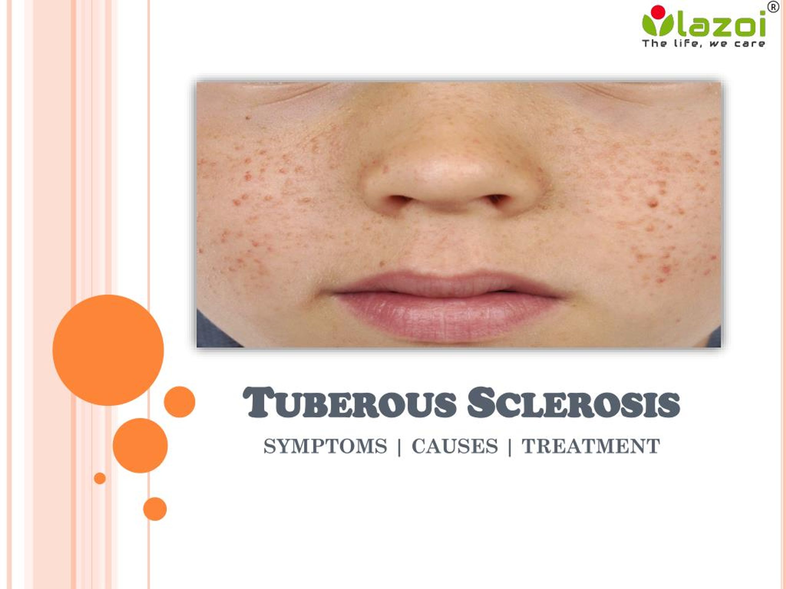 PPT - Tuberous Sclerosis : Causes, Symptoms, Diagnosis, Prevention and Treatment PowerPoint ...