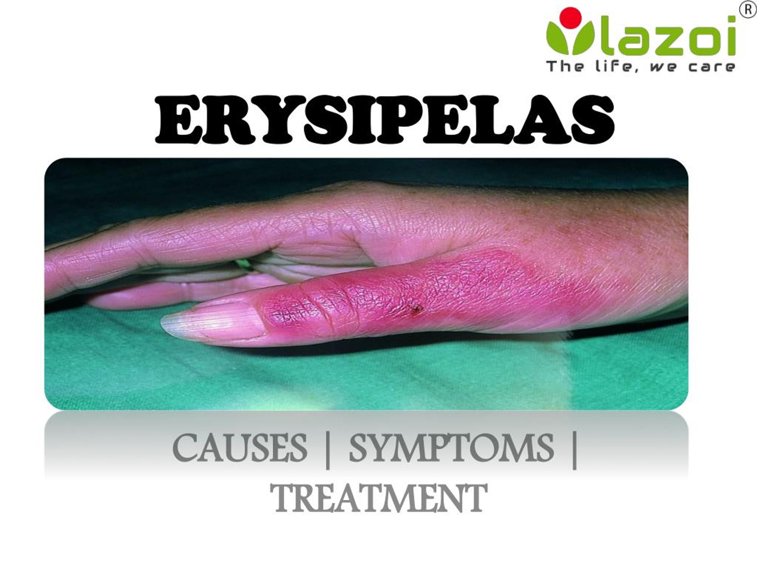 PPT - Erysipelas : causes, symptoms, diagnosis, prevention and ...