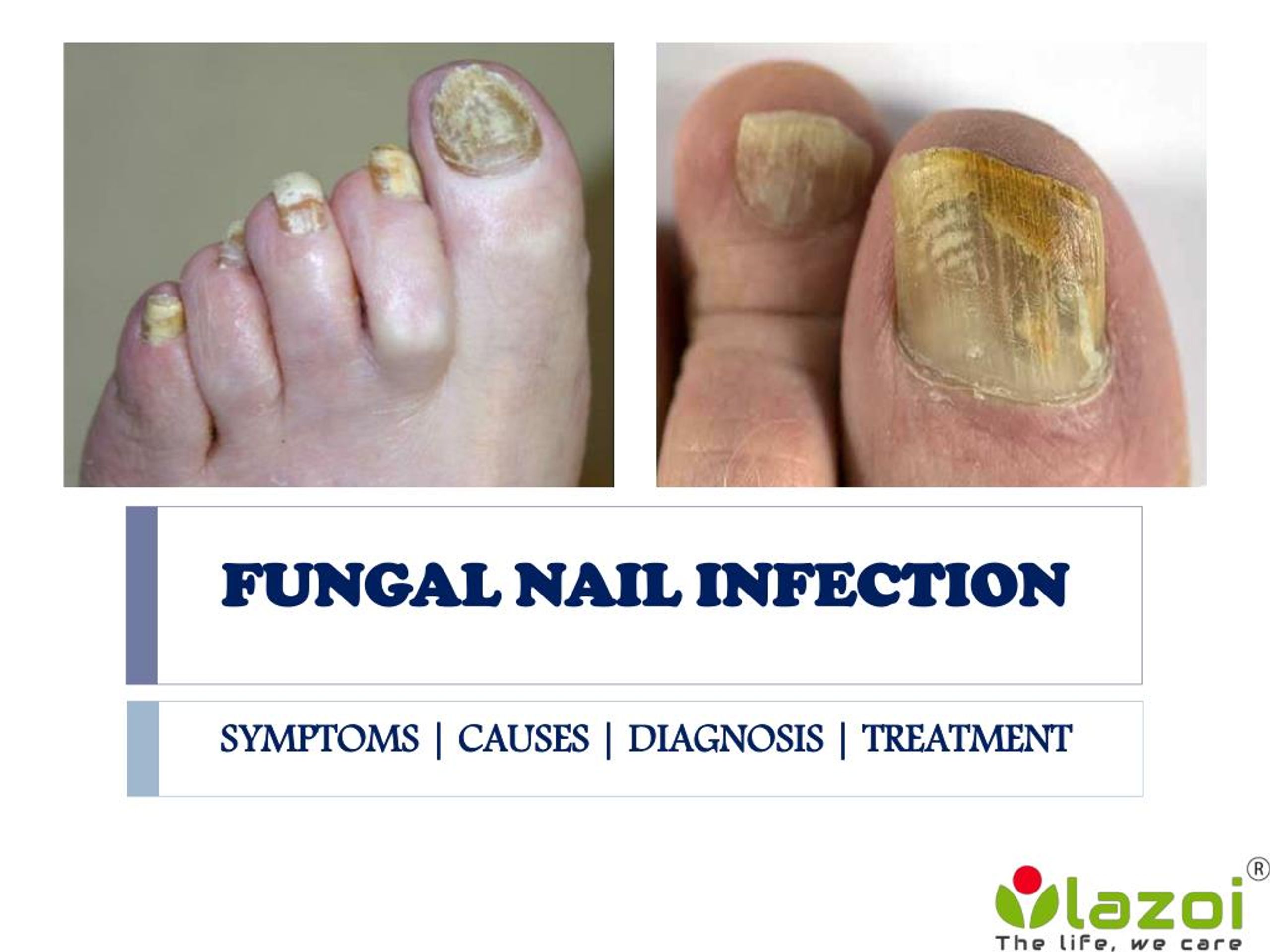PPT - Fungal Nail Infection: causes, symptoms, diagnosis and treatment ...