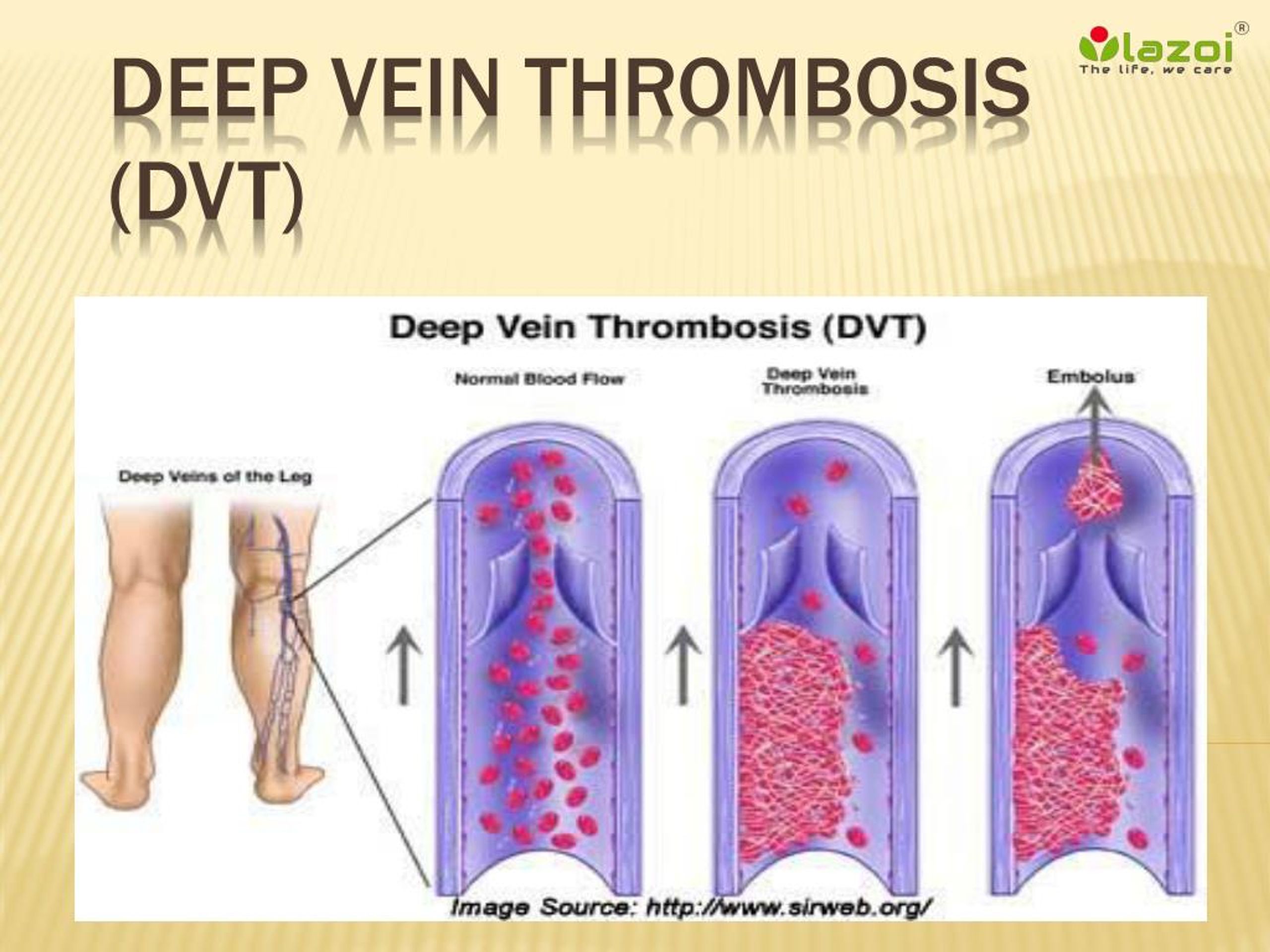 PPT - Deep vein thrombosis (DVT) PowerPoint Presentation, free download ...