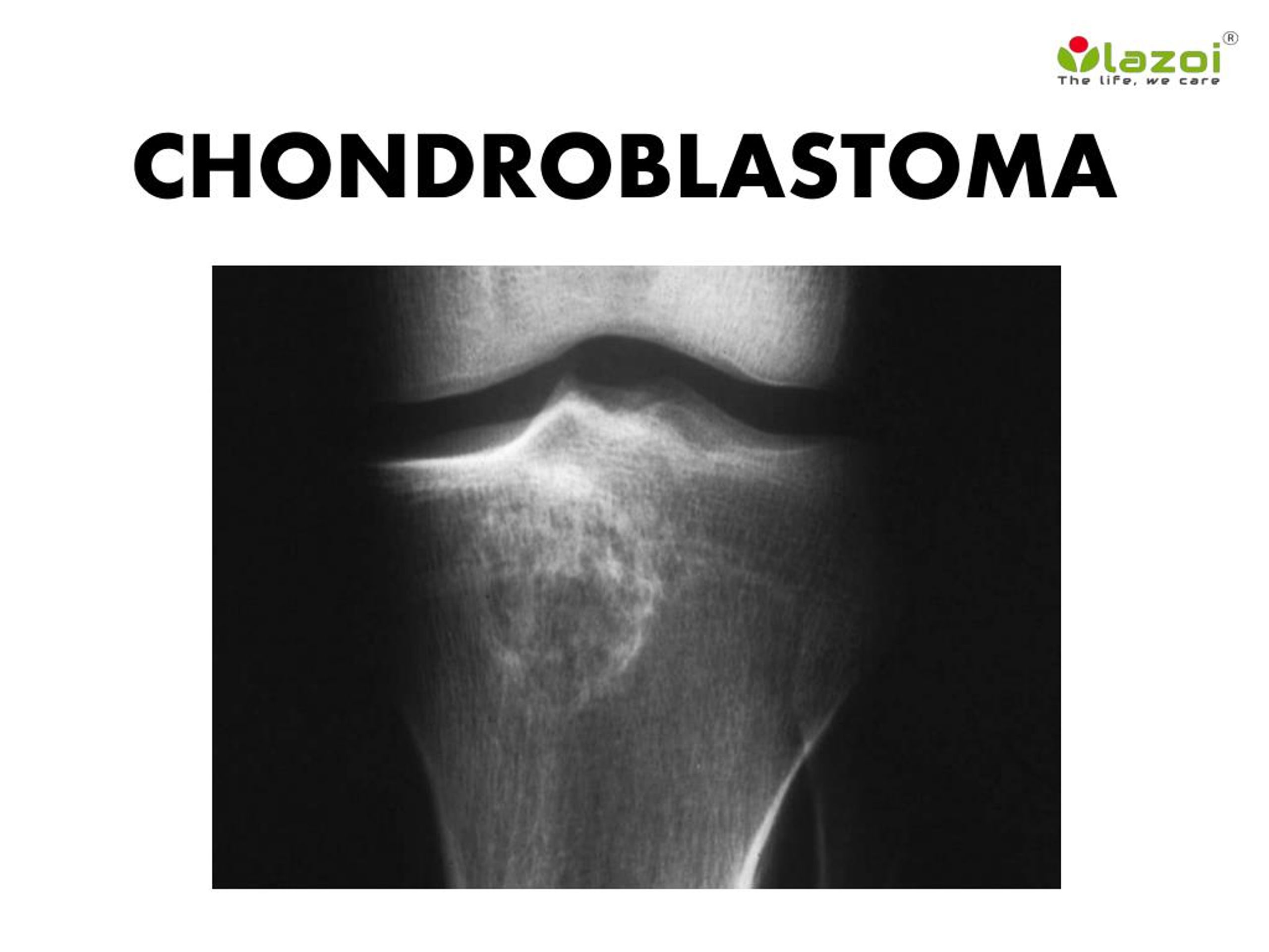 PPT - Chondroblastoma: Symptoms, Causes, Diagnosis and Treatment ...
