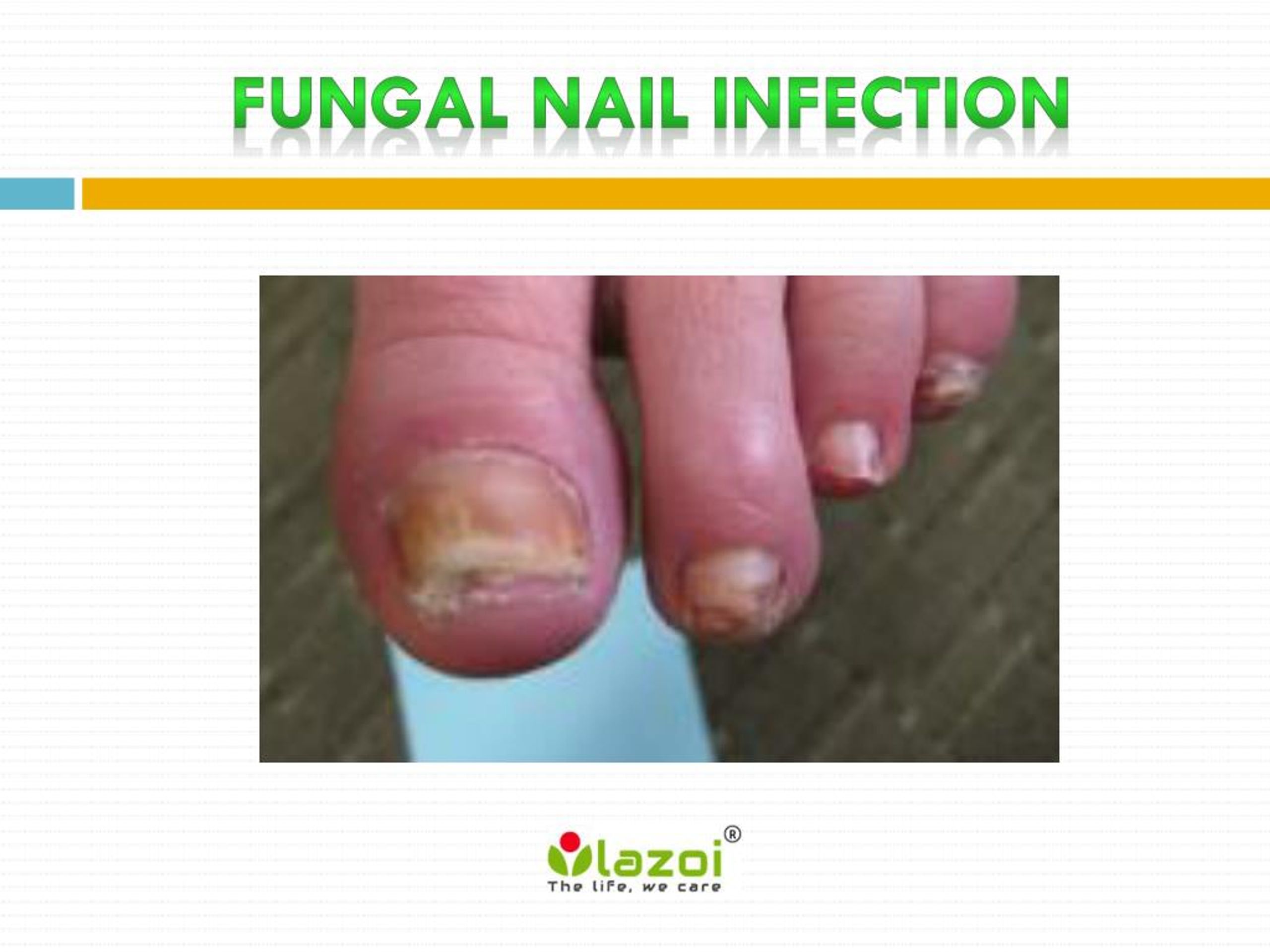 PPT - Fungal Nail Infection: Symptoms, Causes, Risk factors, Diagnosis ...