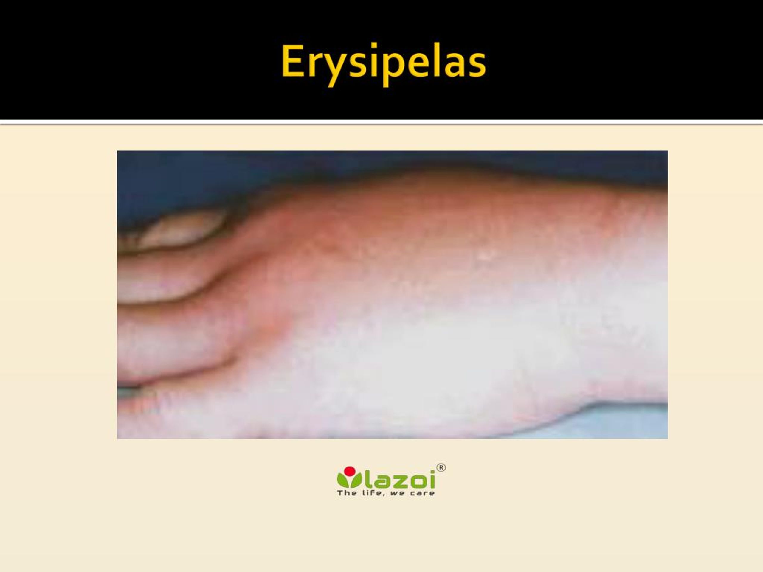 PPT - Erysipelas: Symptoms, Causes, Diagnosis and Treatment PowerPoint ...