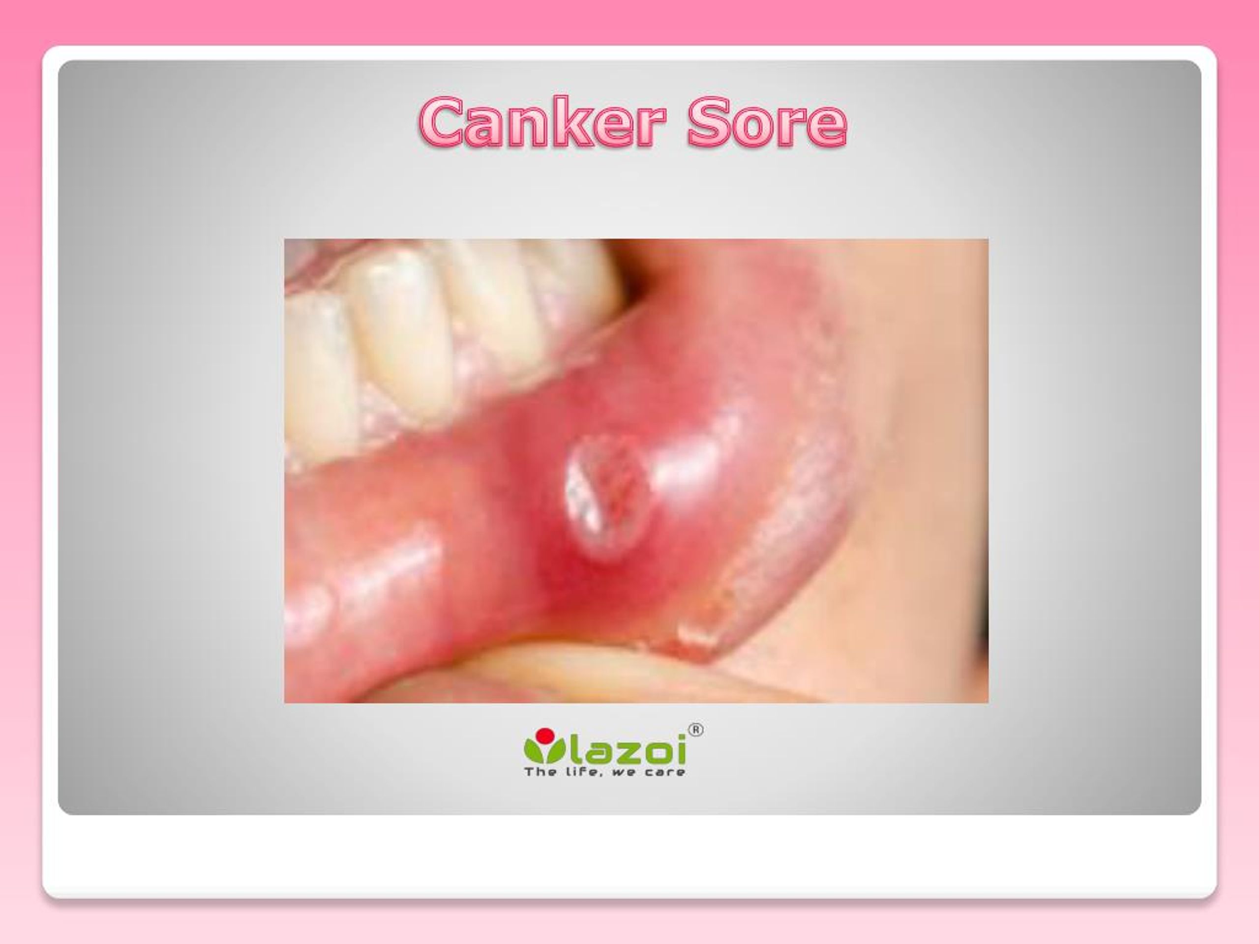PPT - Canker Sore: Causes, Symptoms, Diagnosis and Treatment PowerPoint ...