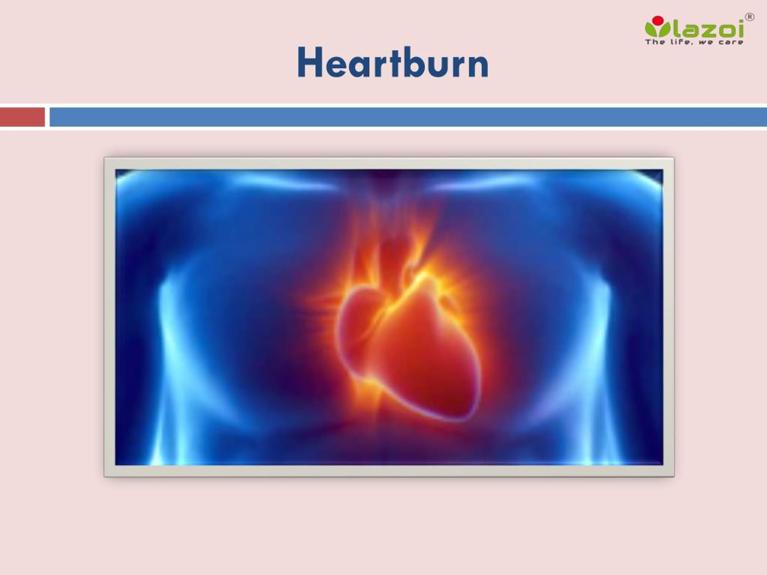PPT - Heartburn: Symptoms, Causes and Treatment PowerPoint Presentation - ID:7667277