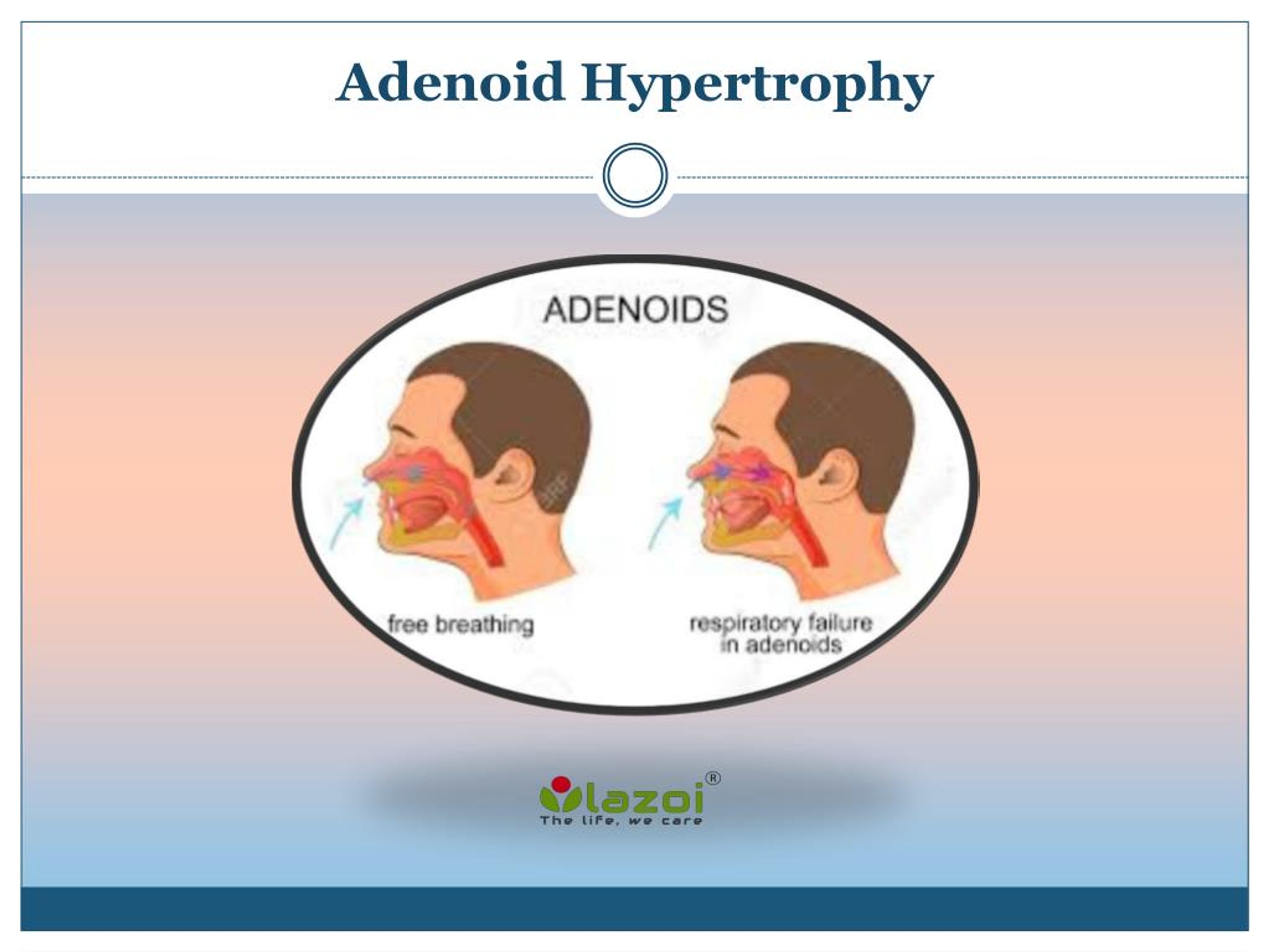 PPT - Adenoid hypertrophy Causes, Symptoms, Diagnosis, Prevention ...