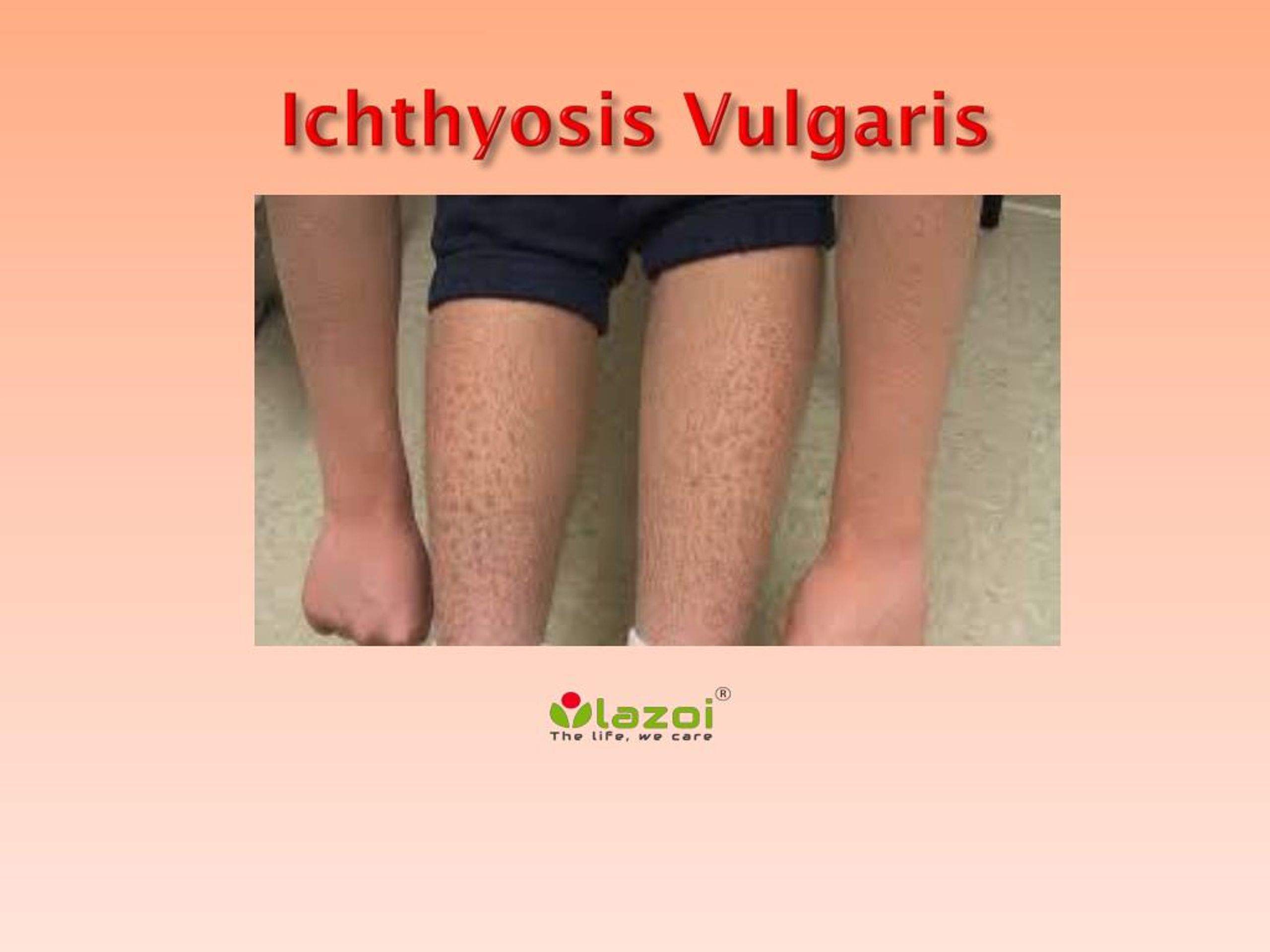 PPT - Ichthyosis Vulgaris: Symptoms, Causes, Diagnosis and Treatment ...