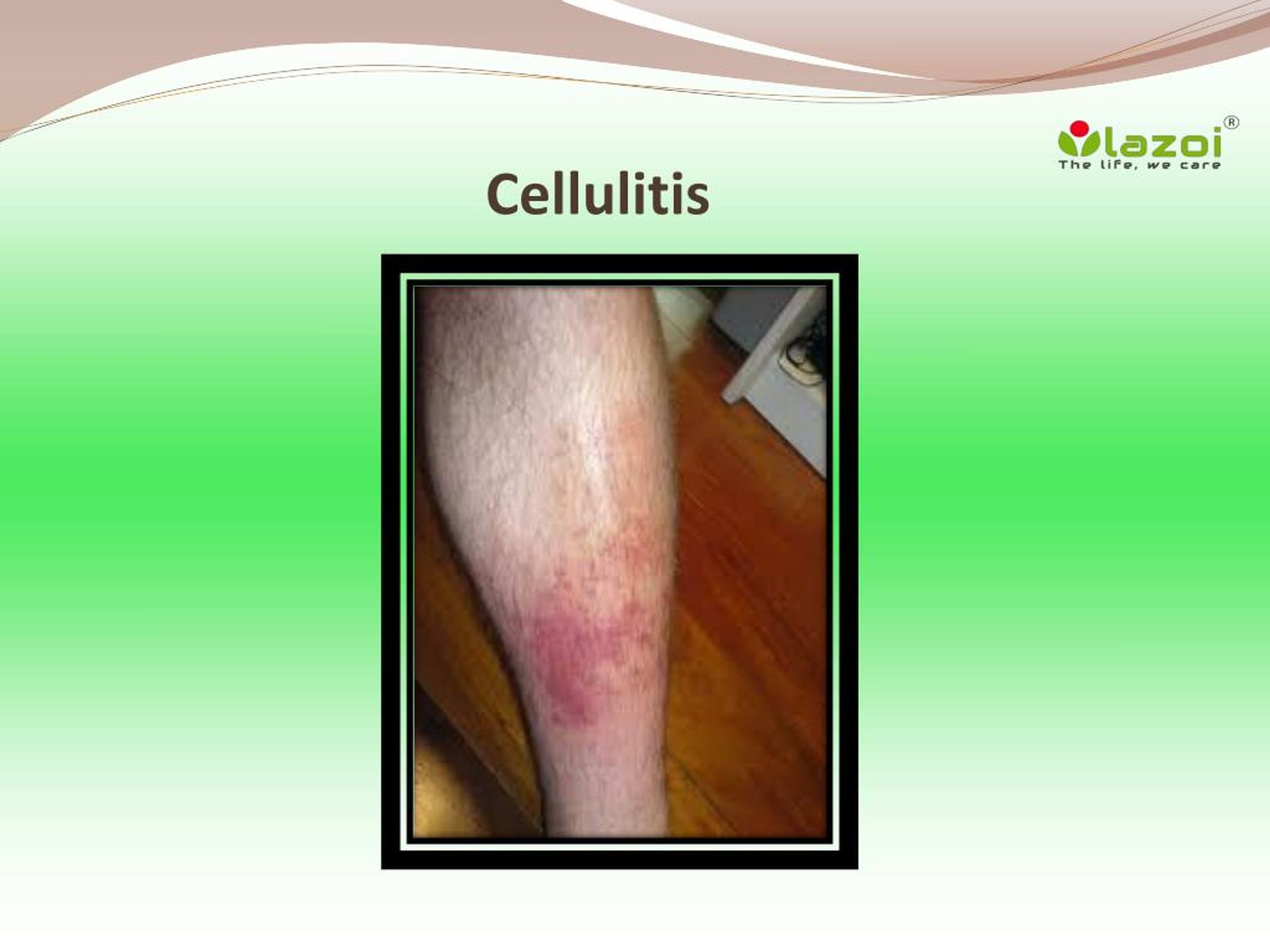 PPT - Cellulitis: Symptoms, Causes, Diagnosis, Treatment, Prevention ...
