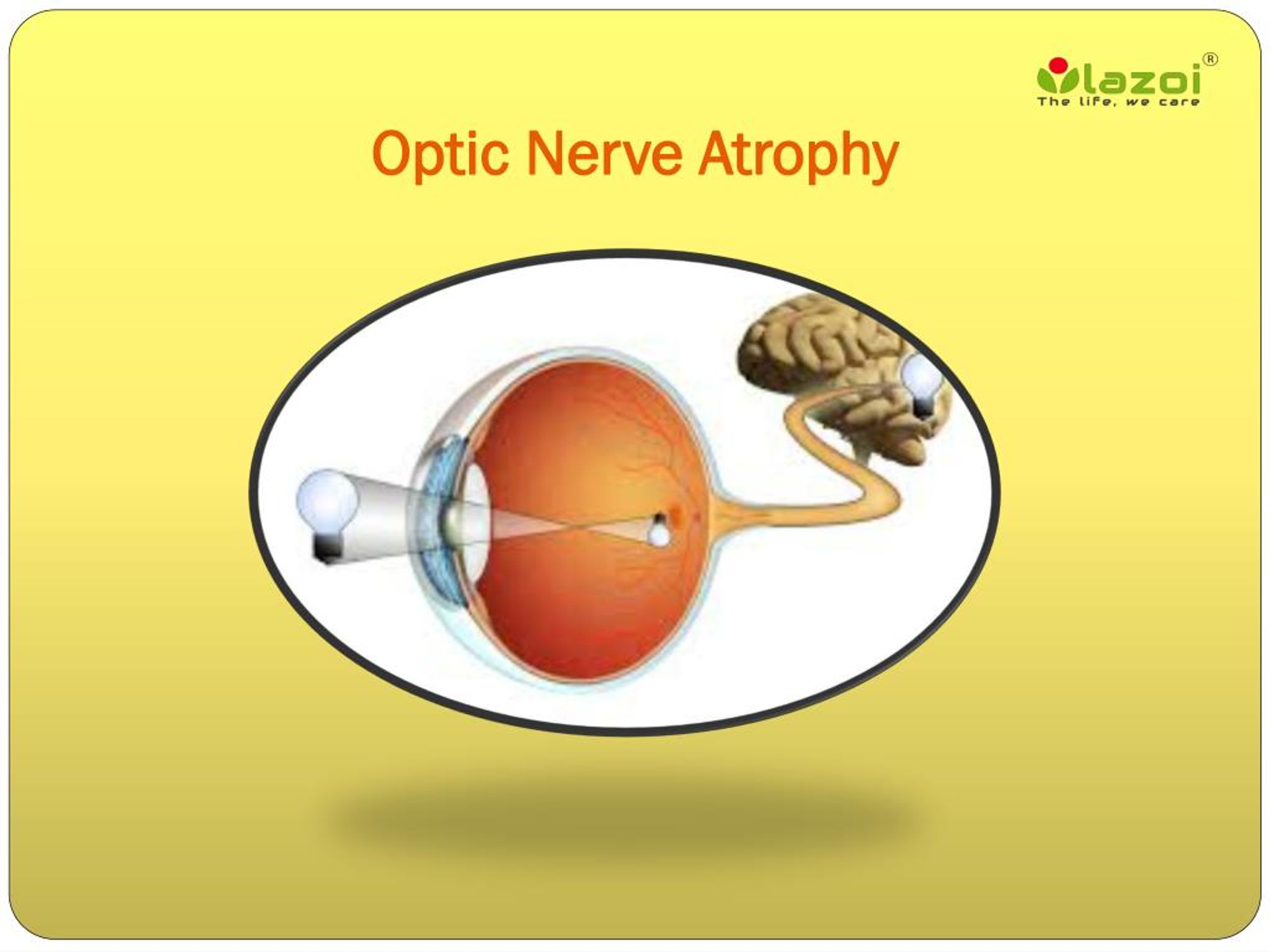 PPT - Optic Nerve Atrophy: A guide to symptoms, causes and treatment ...