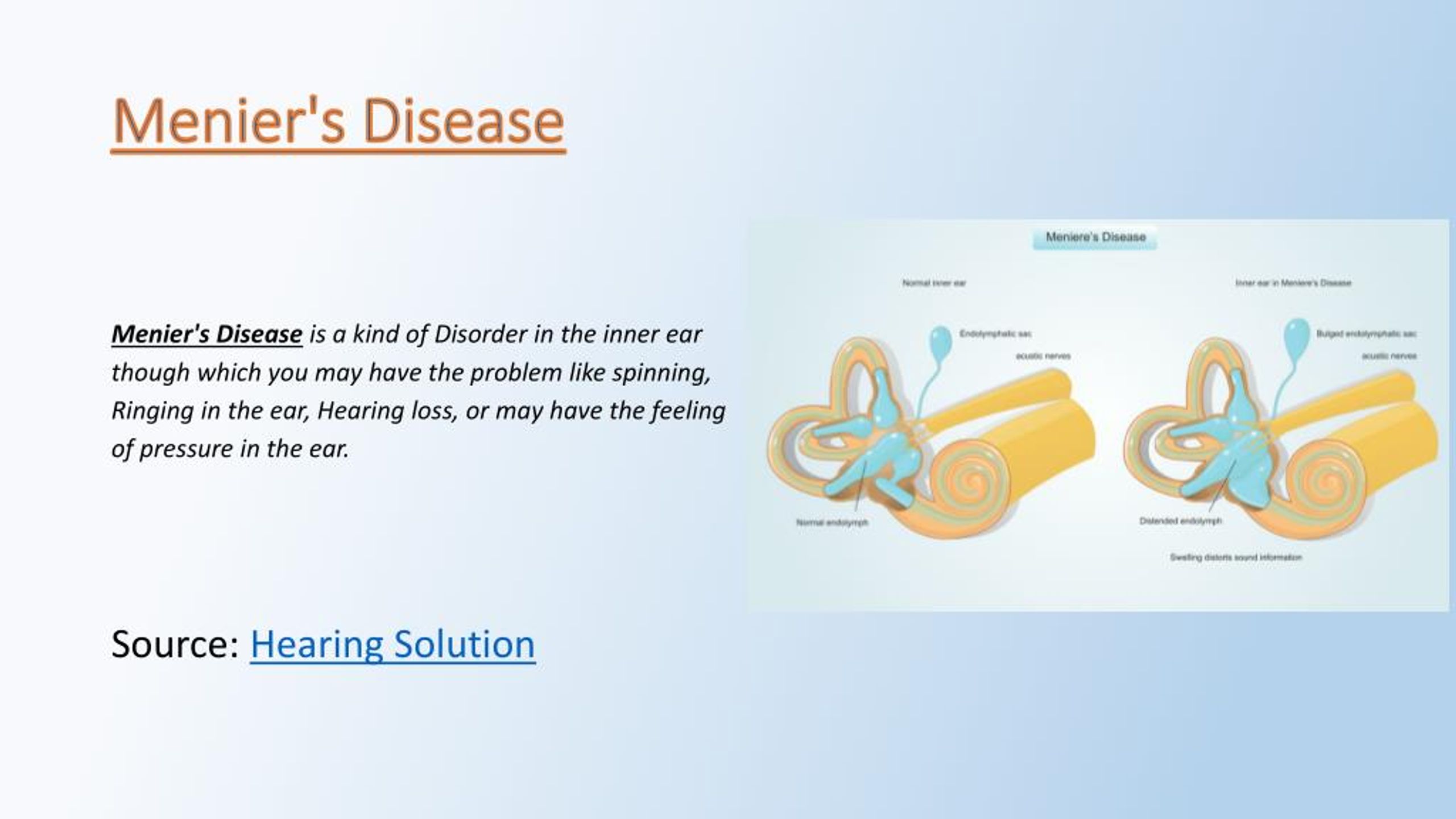 PPT - Meniere's Disease PowerPoint Presentation, free download - ID:7925726