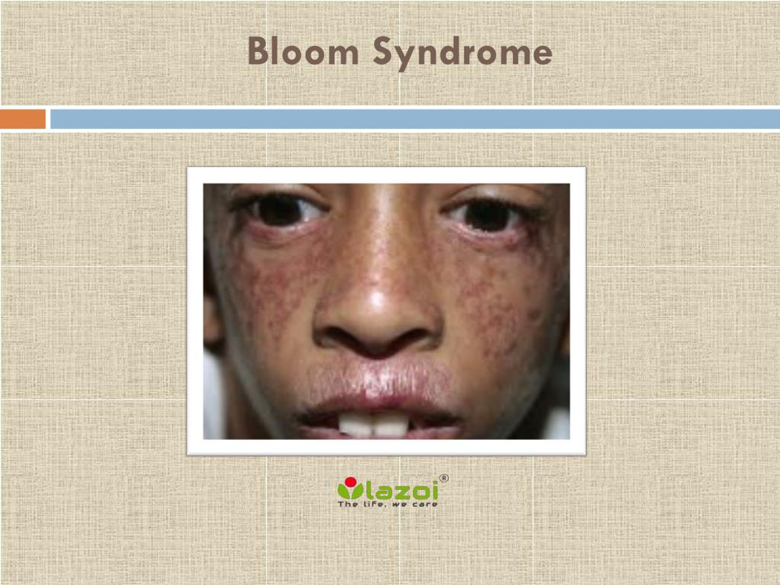 PPT - Bloom Syndrome PowerPoint Presentation, free download - ID:7929298