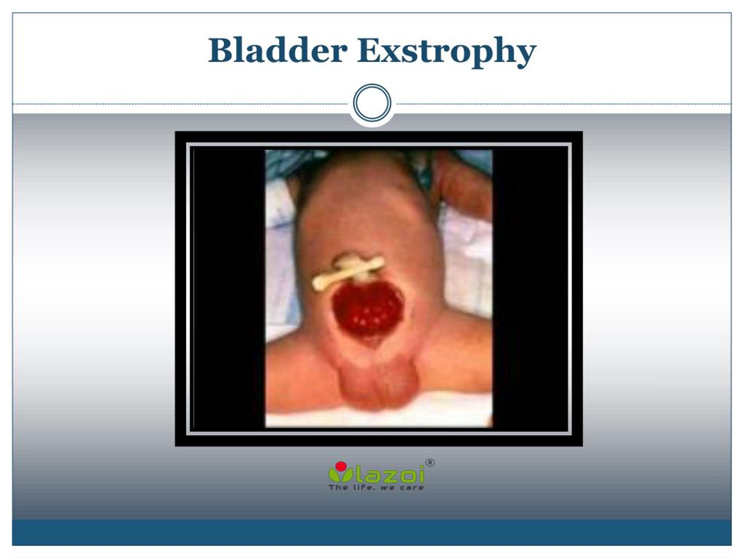 PPT - Bladder Exstrophy PowerPoint Presentation, free download - ID:7932163