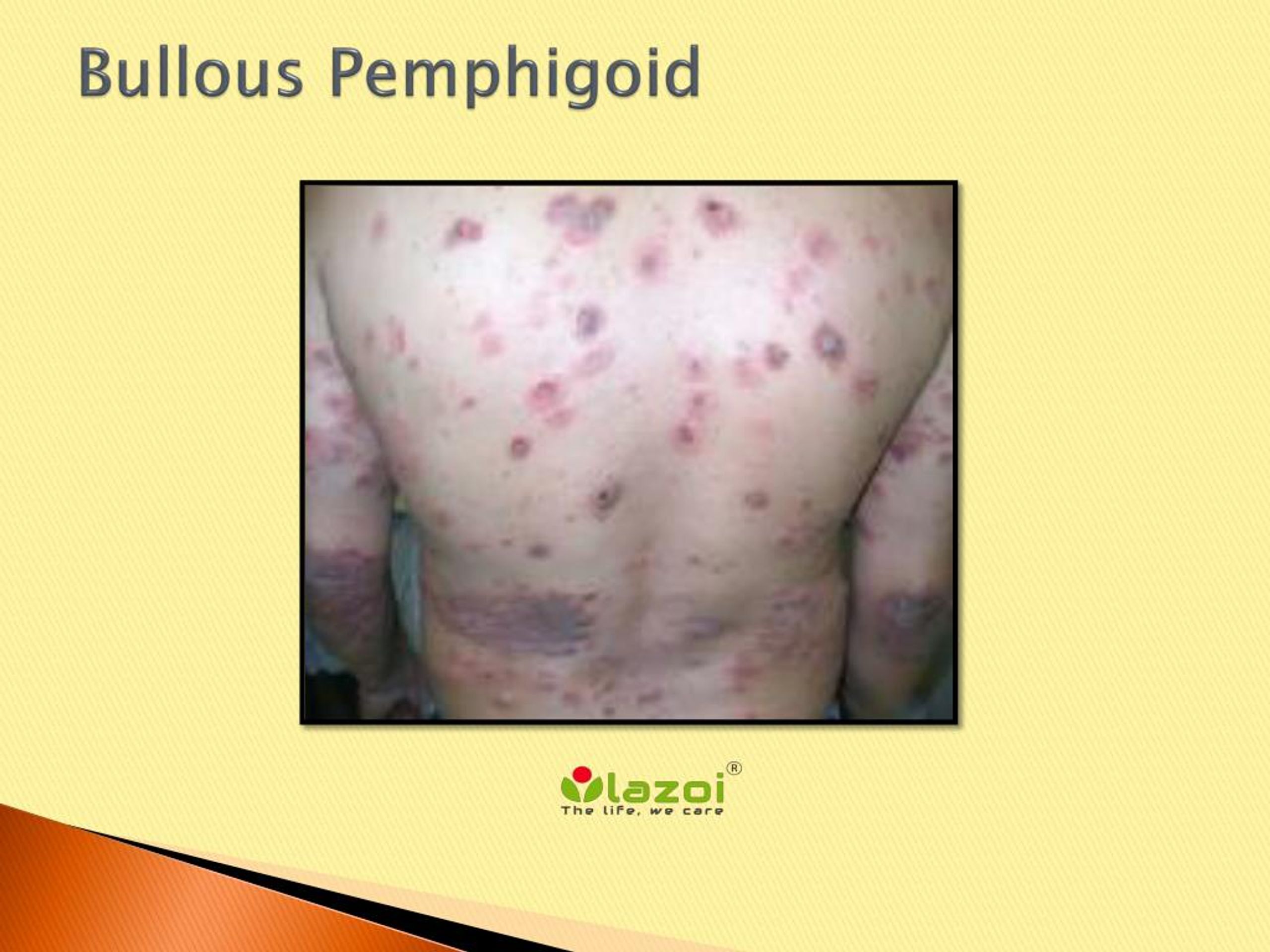 PPT - Bullous Pemphigoid PowerPoint Presentation, free download - ID ...