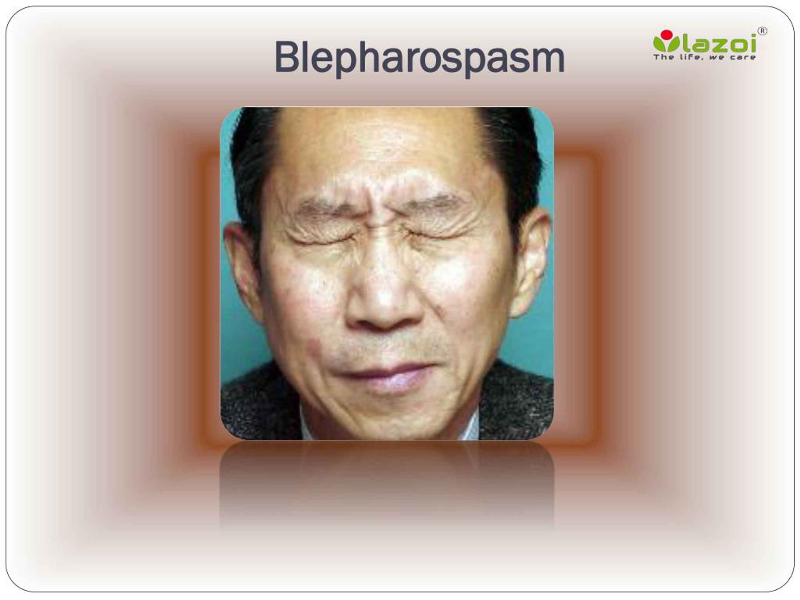 PPT - Blepharospasm PowerPoint Presentation, free download - ID:7933645