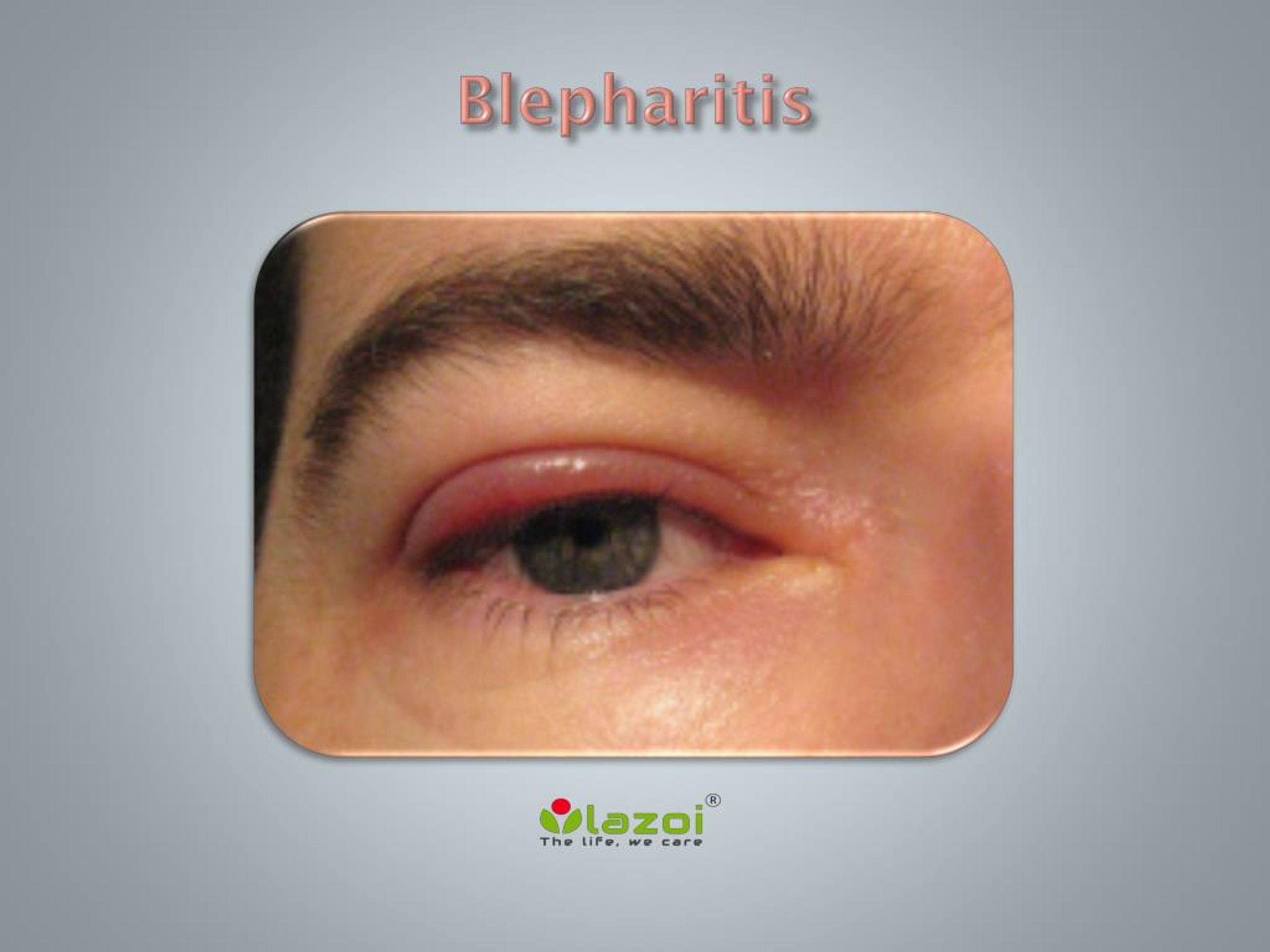 PPT - Blepharitis PowerPoint Presentation, free download - ID:7935104