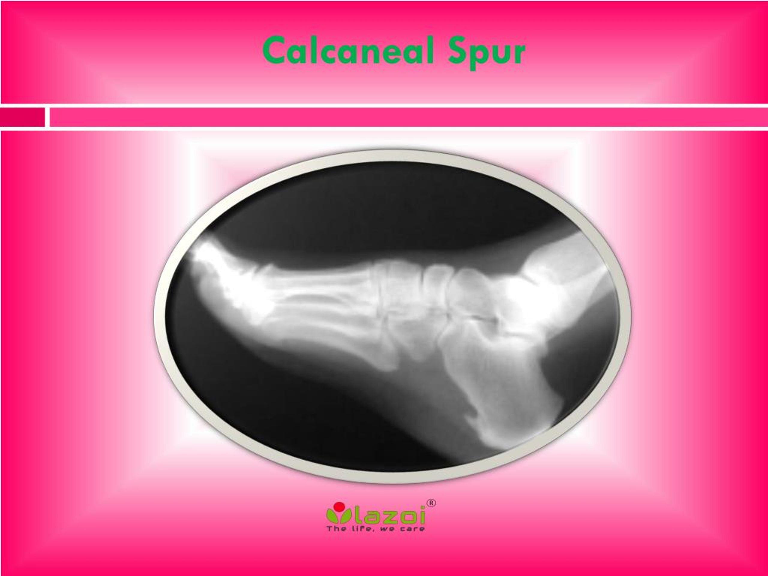 PPT - Calcaneal Spur PowerPoint Presentation, free download - ID:7940136