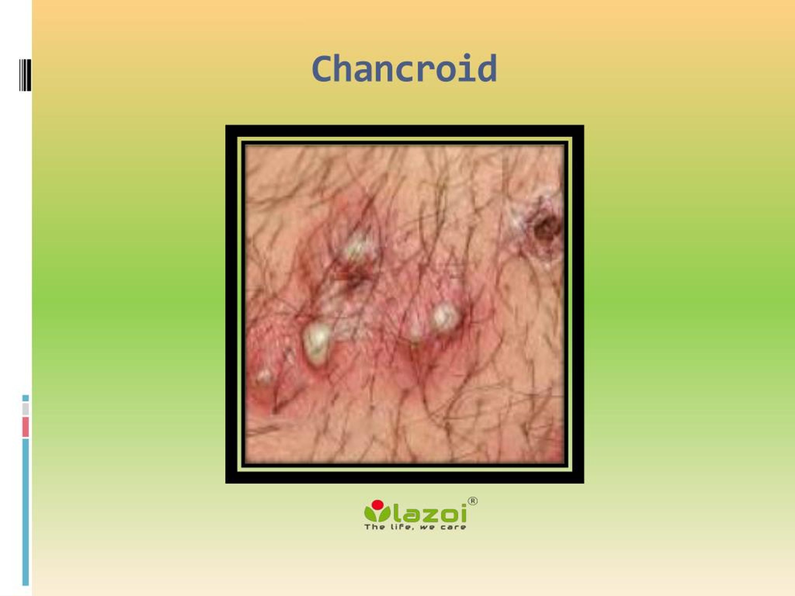PPT - Chancroid PowerPoint Presentation, free download - ID:7940148