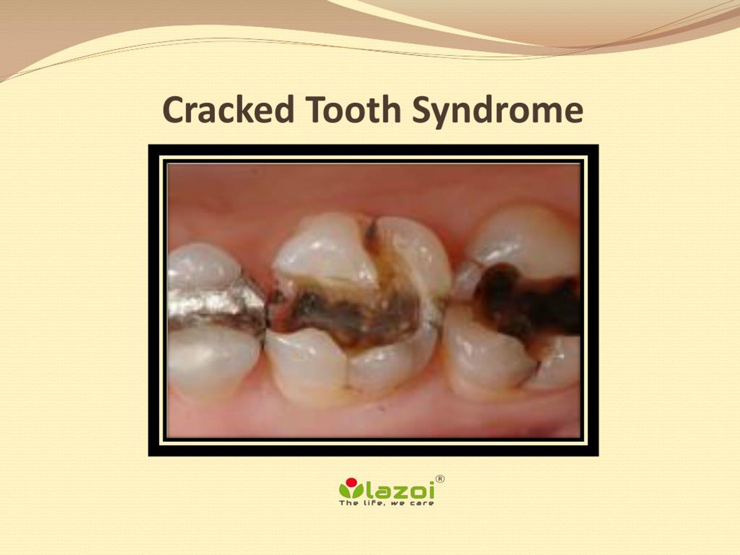 PPT - Cracked Tooth Syndrome PowerPoint Presentation, free download ...