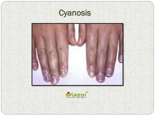 PPT - Cyanosis PowerPoint Presentation, free download - ID:1341572