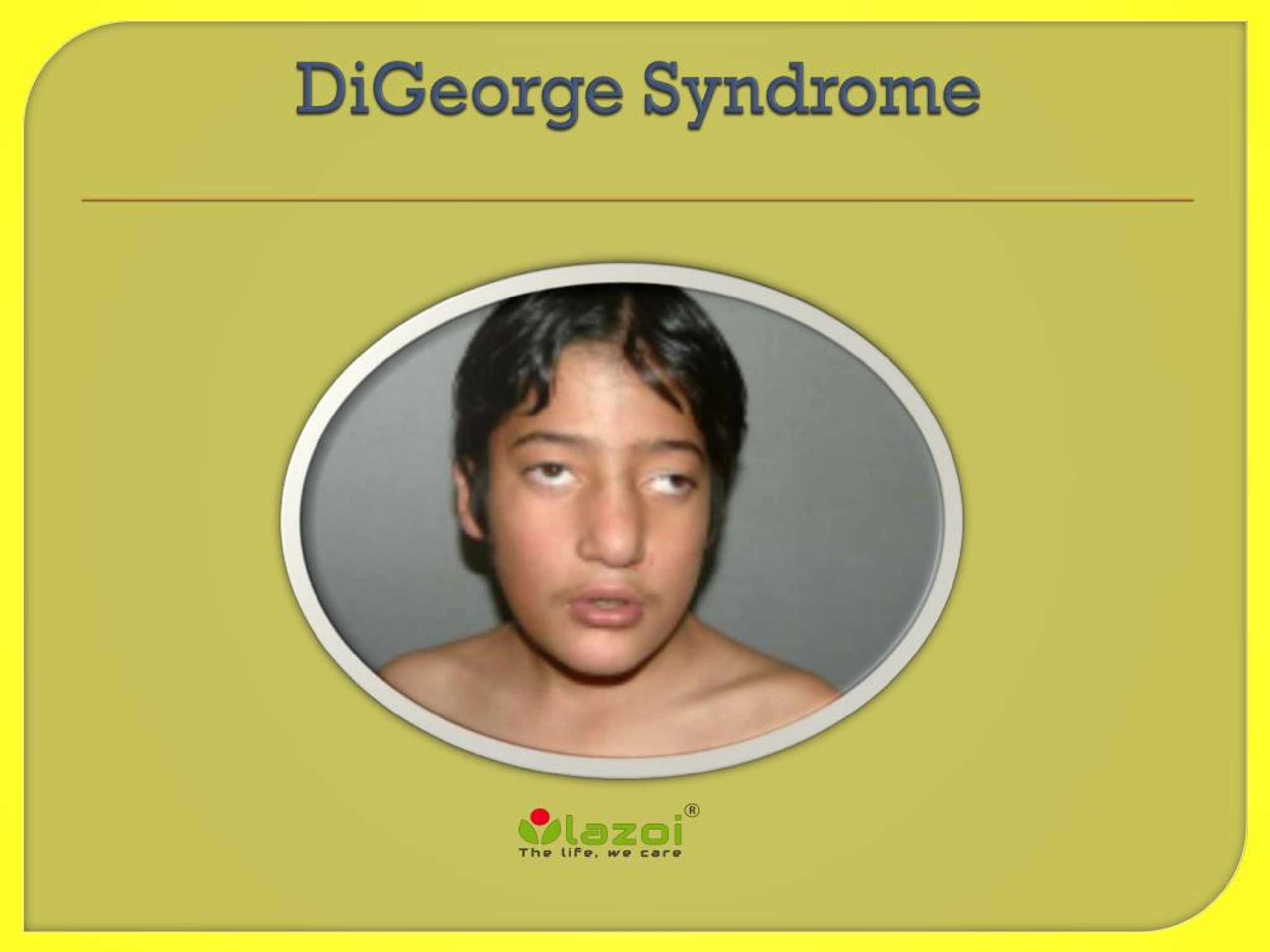 PPT - DiGeorge Syndrome PowerPoint Presentation, free download - ID:7943710