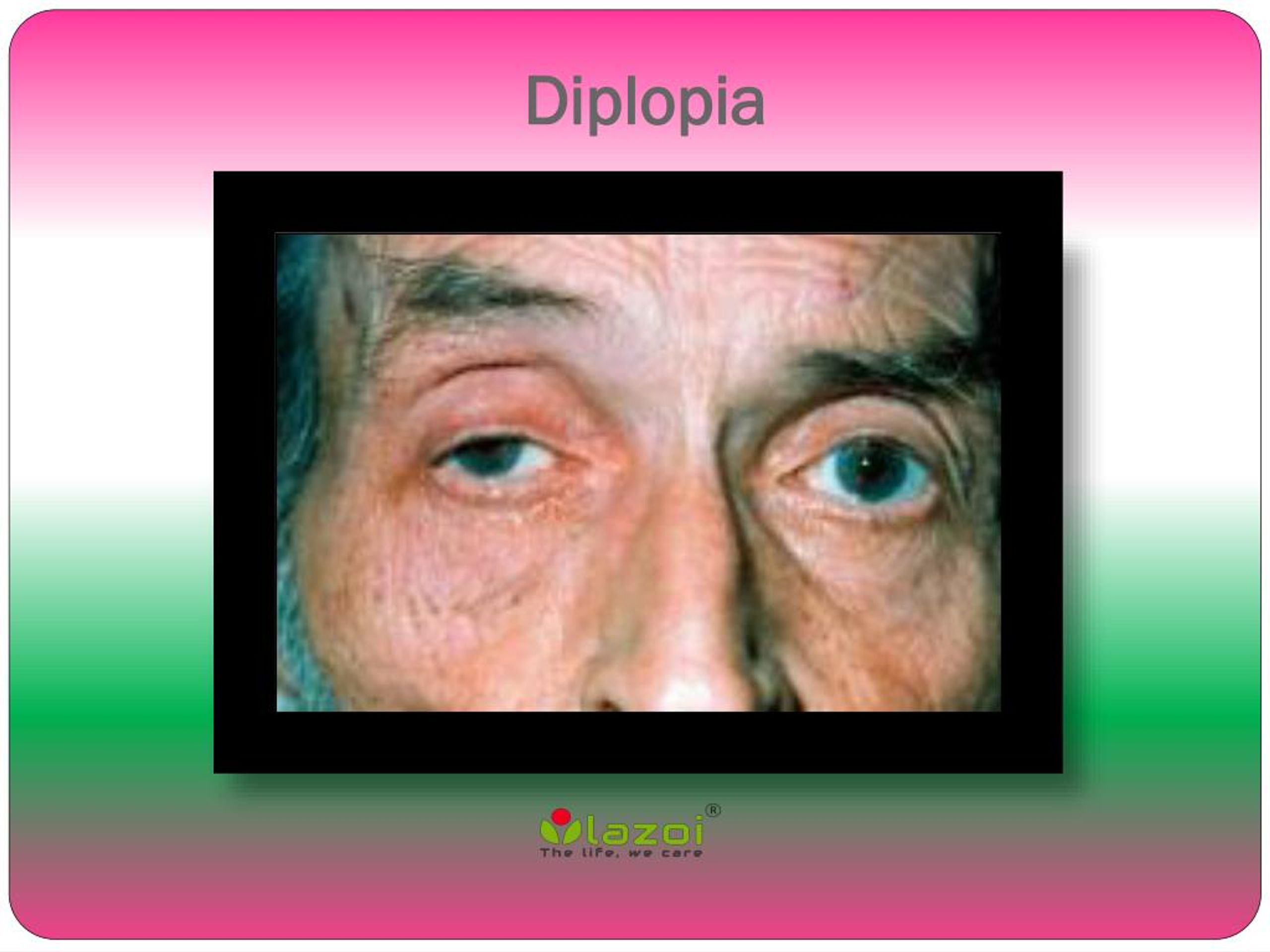 PPT - Diplopia PowerPoint Presentation, free download - ID:7945159