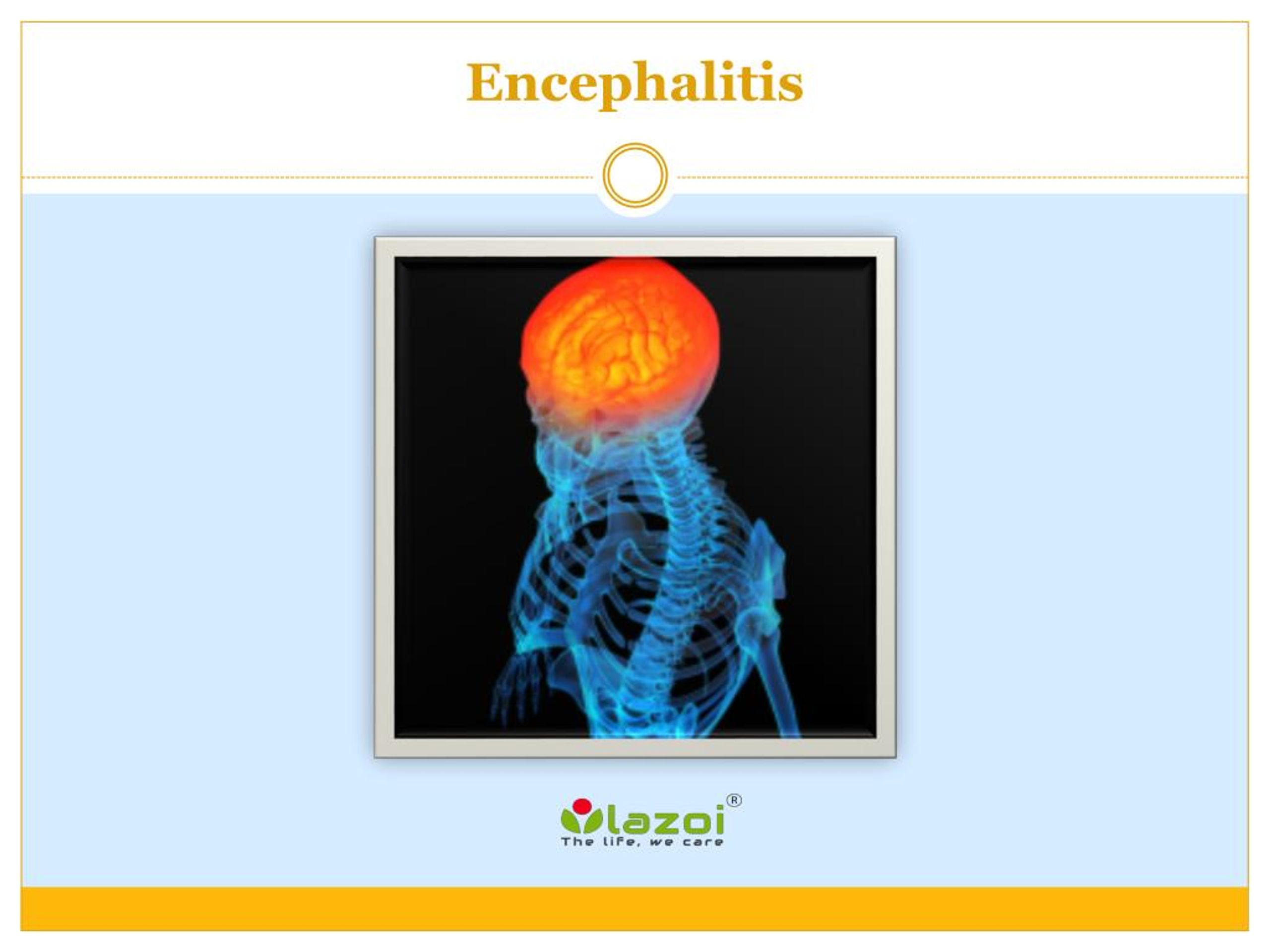 PPT - Encephalitis PowerPoint Presentation, free download - ID:7949287