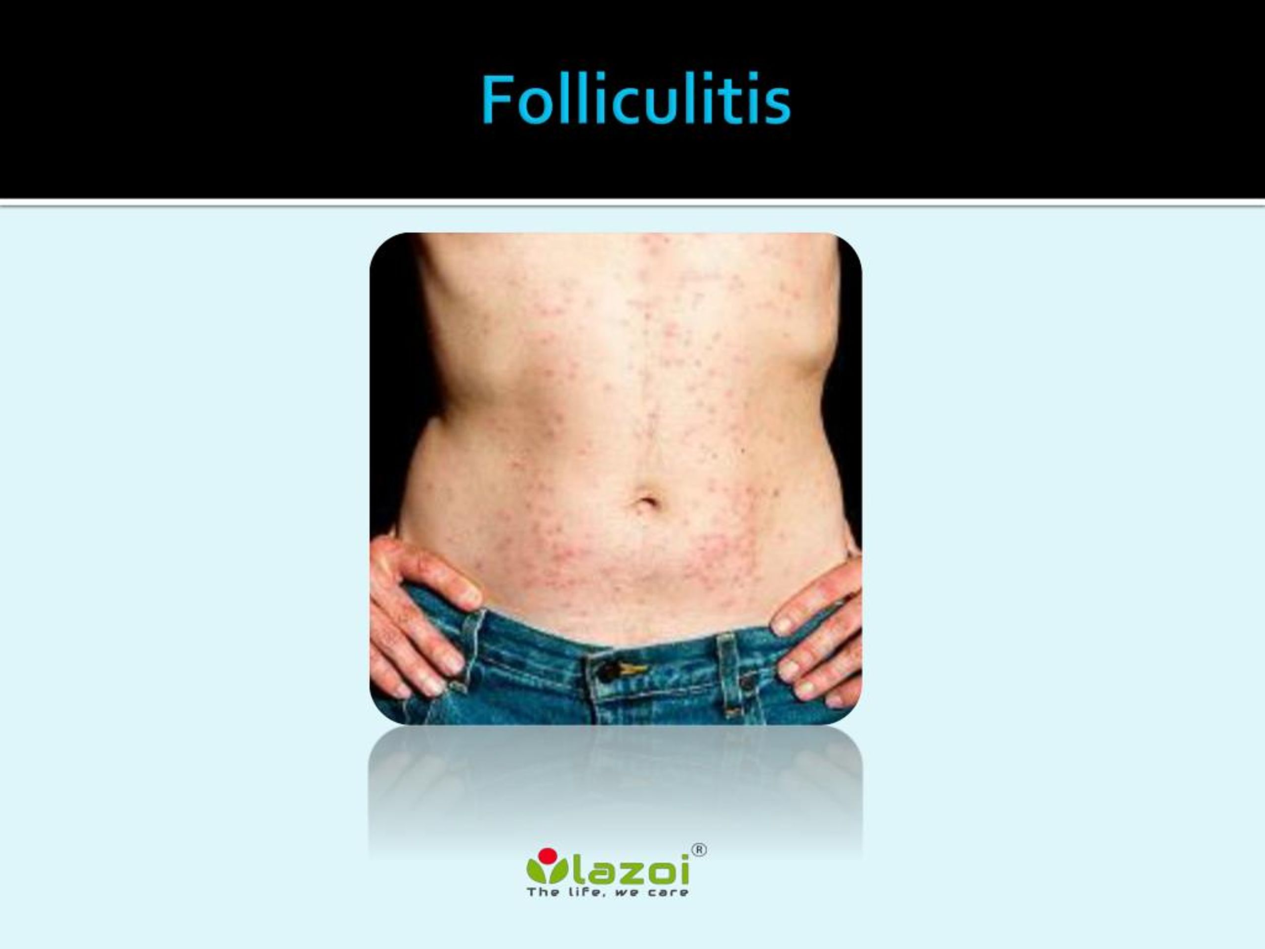 PPT - Folliculitis PowerPoint Presentation, free download - ID:7953310