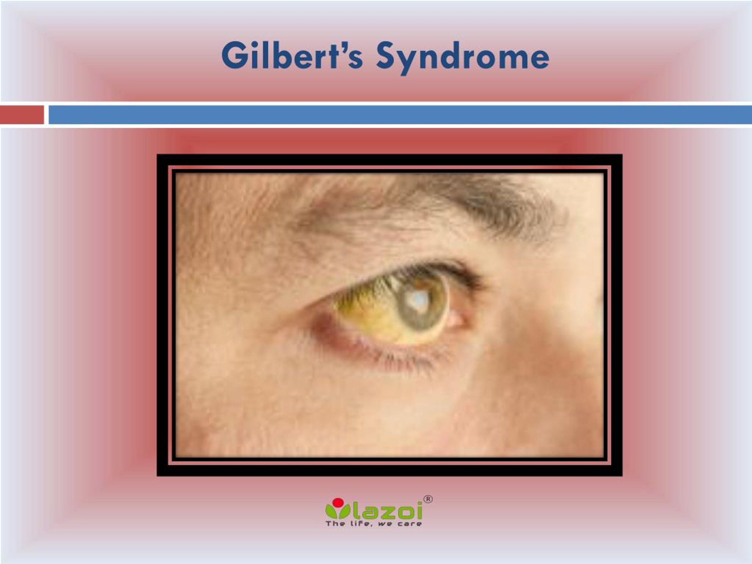 PPT - Gilbertâ€™s Syndrome PowerPoint Presentation, free download - ID ...